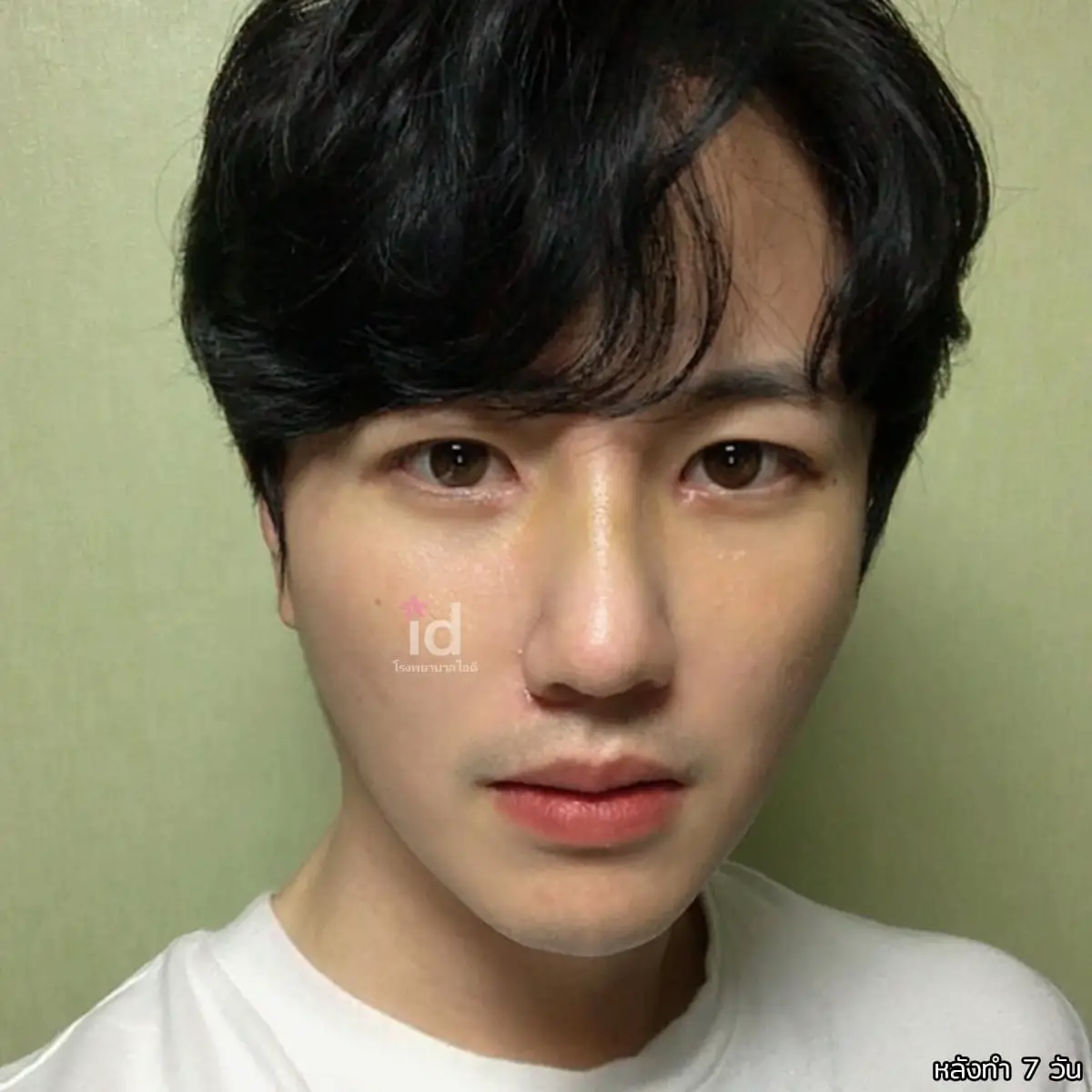 ศัลยกรรมผู้ชาย | แกลเลอรีที่โพสต์โดย Noom BTF | Lemon8