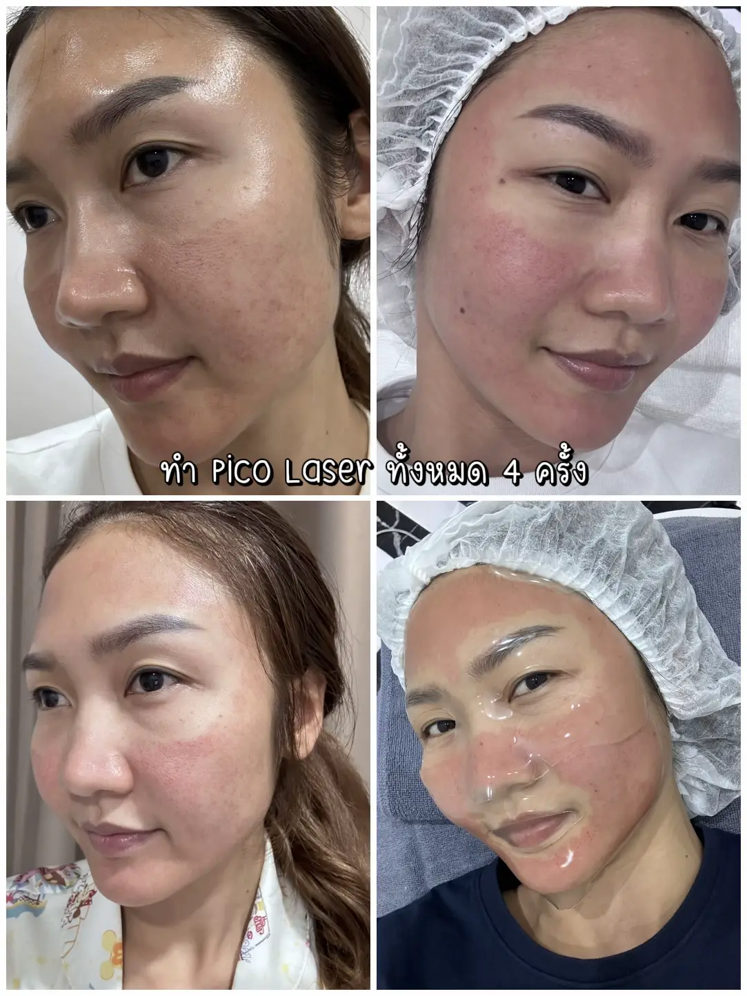 รีวิวแบบไม่อวย Pico Laser ปังหรือพัง ⁉️ | แกลเลอรีที่โพสต์โดย Aomiiz Aom | Lemon8