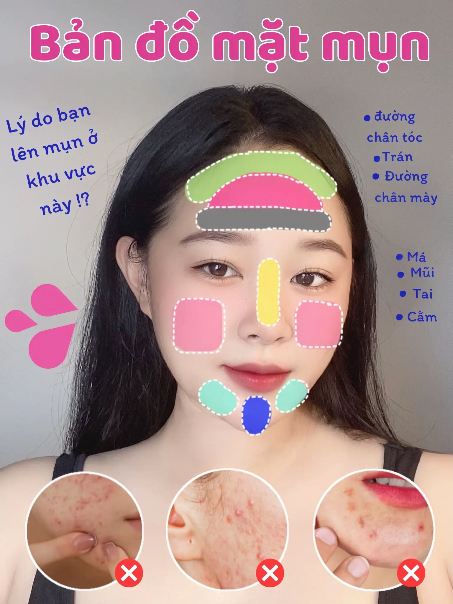 NGUYÊN NHÂN LÊN MỤN TỪNG VÙNG KHUÔN MẶT | Bộ sưu tập do Bảo Bối 🍀 đăng ...