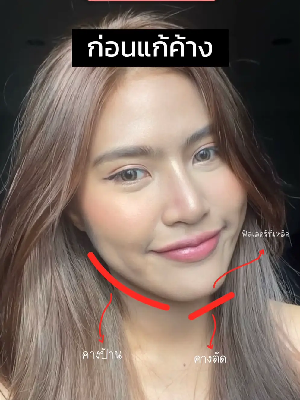 รีวิวแก้คางที่ Emma Cilnic ดีจริงหรือจกตา? | แกลเลอรีที่โพสต์โดย ...