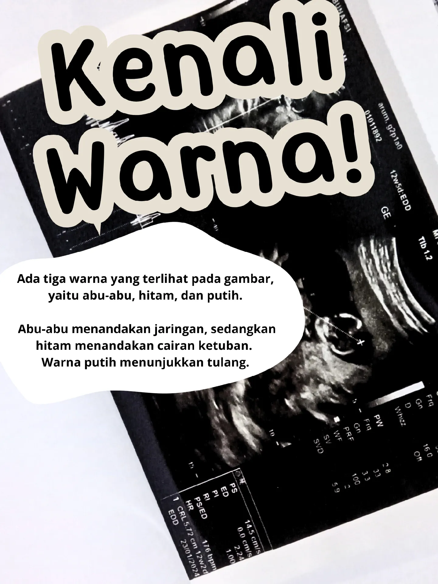 Hasil Usg 2 Bulan 2024 - Pencarian Lemon8