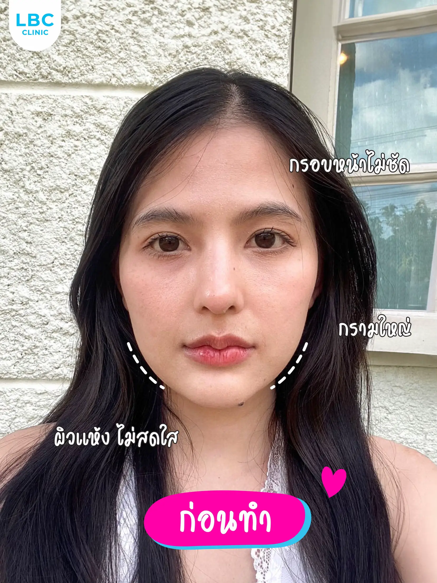 botoxกราม lbc - การค้นหาใน Lemon8