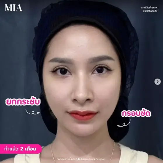 ☁️ รีวิวเคสจริง กับ HIFU หน้ายุง ☁️ | แกลเลอรีที่โพสต์โดย MIA รีวิว | Lemon8