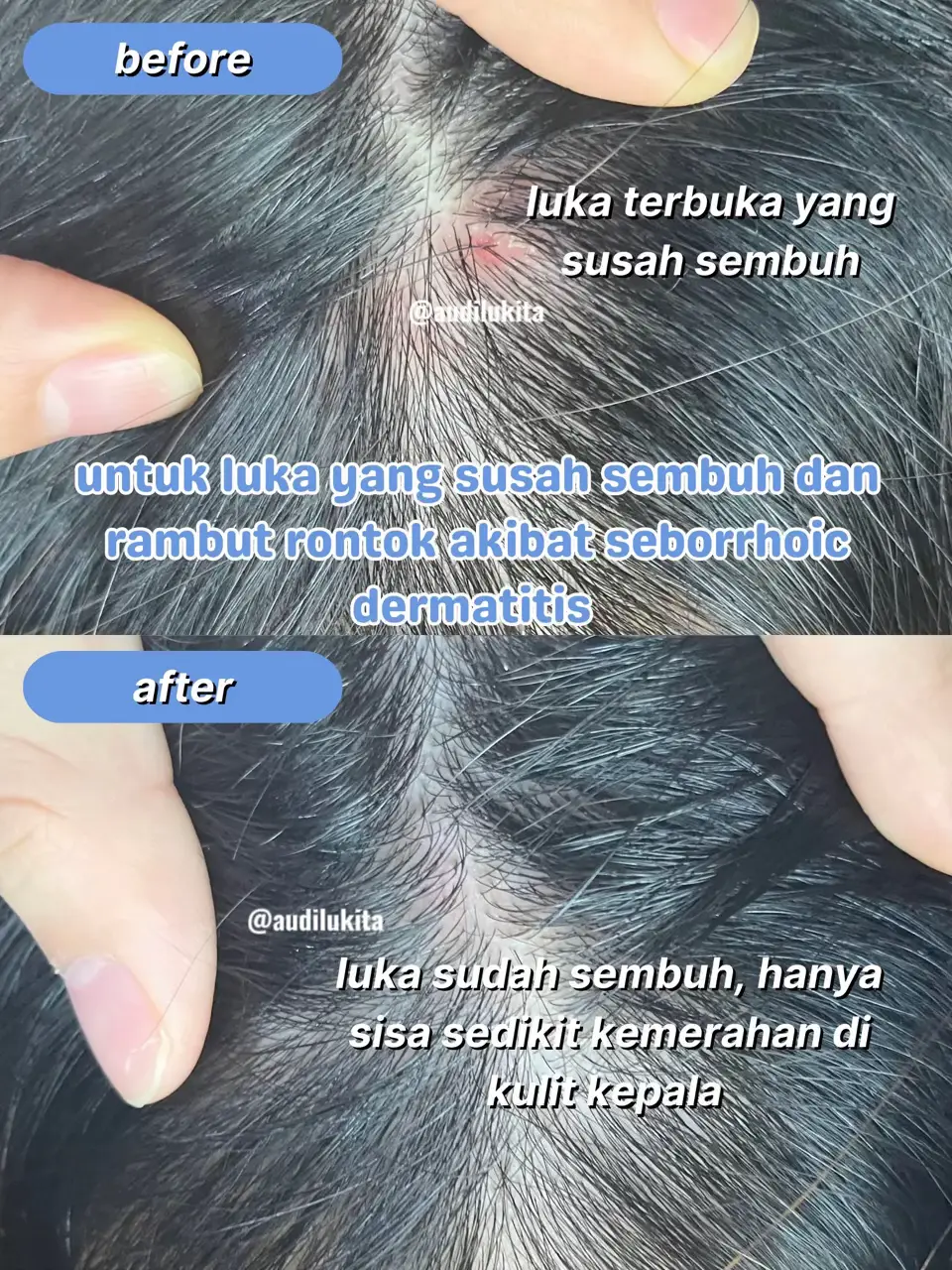 Zinc Supplement untuk Luka, Jerawat, dan Rambut! | Galeri diposting ...