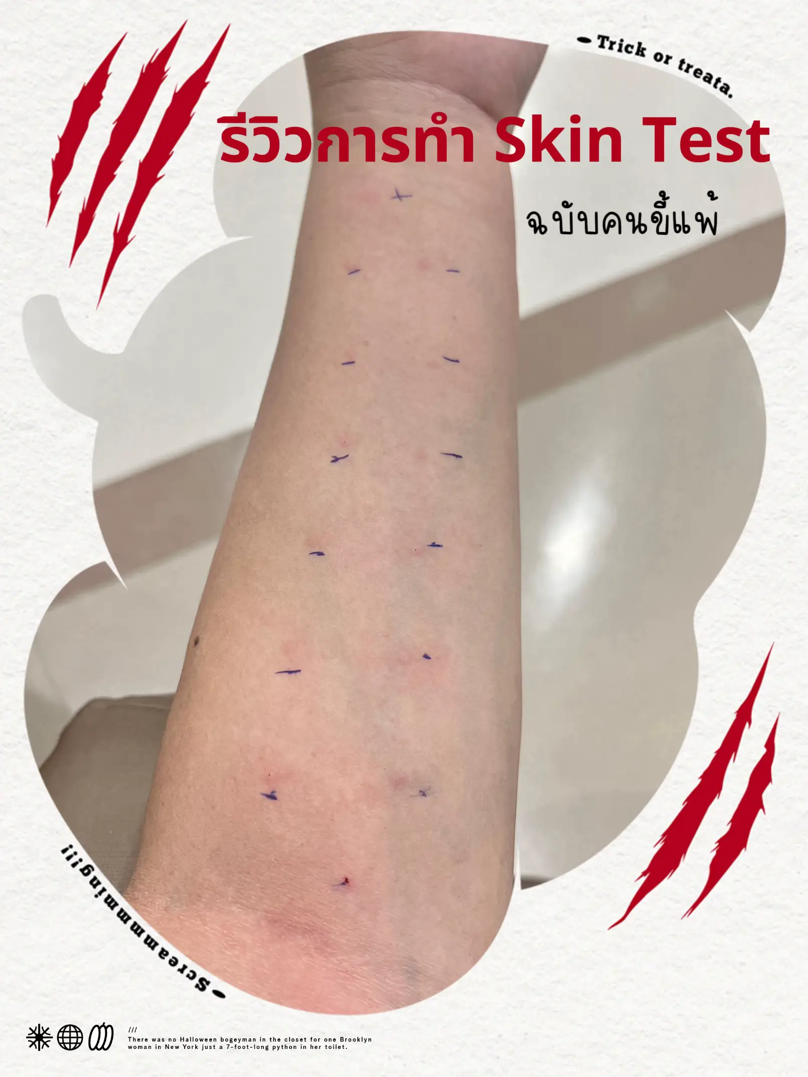 รีวิวการทำ Skin Test ฉบับคนขี้แพ้ 💉💊💪🏻 | แกลเลอรีที่โพสต์โดย Worra B ...