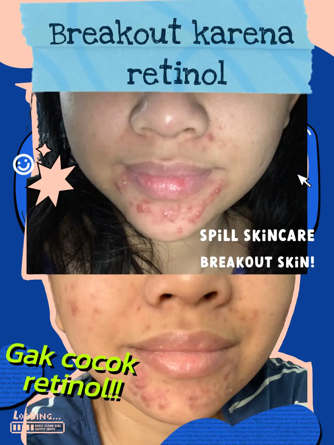 Skincare for Breakout Skin! | Galeri diposting oleh ghina pitaloka | Lemon8