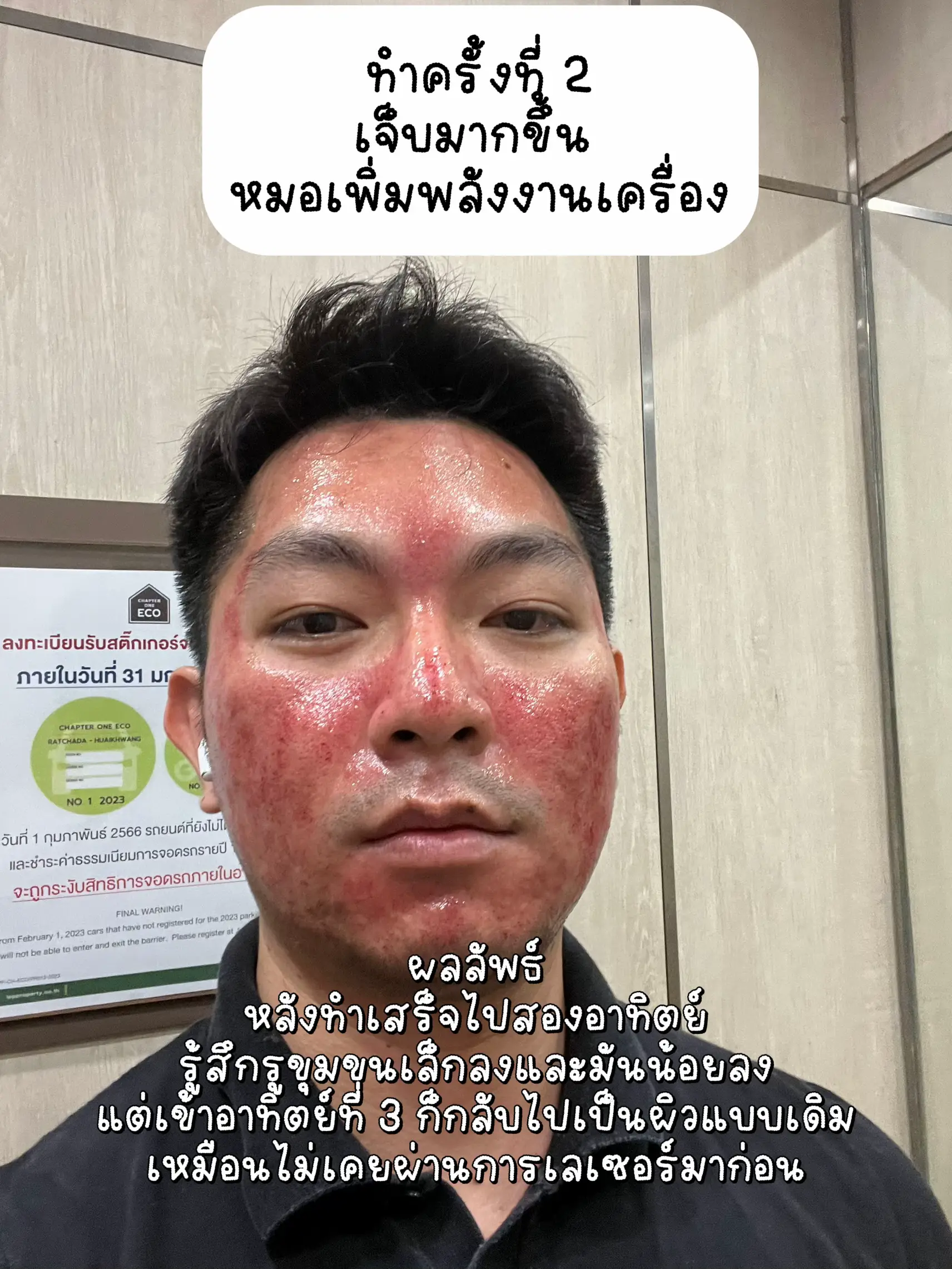 พลีชีพ ทำ PICO 6 ครั้ง แบบไม่มีอะไรเปลี่ยนเลย | แกลเลอรีที่โพสต์โดย Lec ...