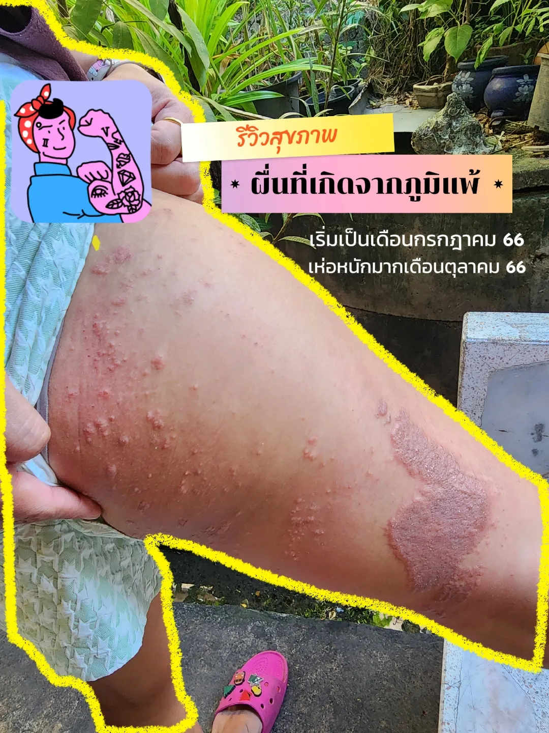 รีวิวสุขภาพตัวเอง🤍แชร์ประสบการณ์ภูมิคุ้มกันตก | แกลเลอรีที่โพสต์โดย Patcharee Sae | Lemon8