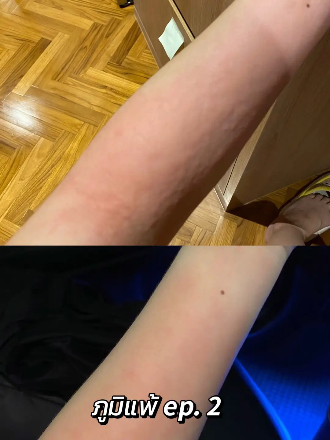 #แพมรักษาภูมิแพ้ ep. 2 | วิดีโอที่เผยแพร่โดย Pam T. | Lemon8