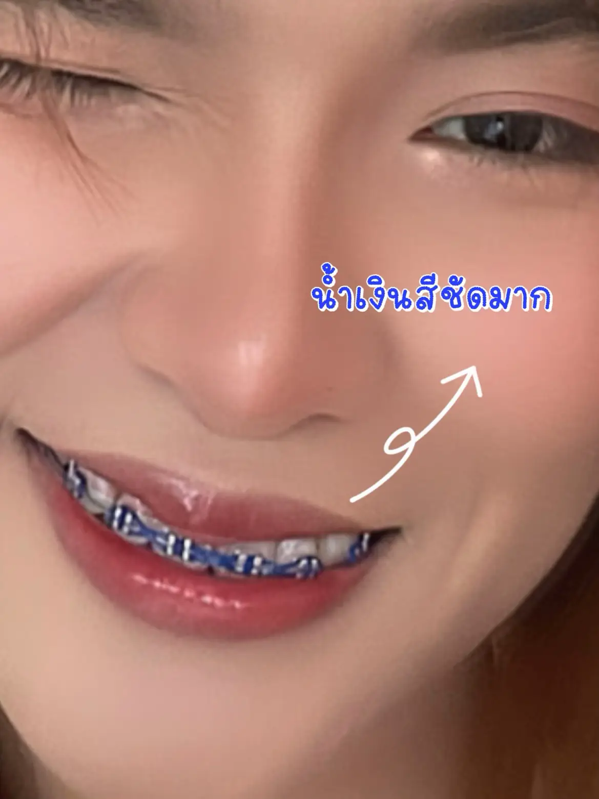 รีวิวสียางจัดฟันที่ชอบ😍 | แกลเลอรีที่โพสต์โดย Pk_cbn🐍 415🌈 | Lemon8