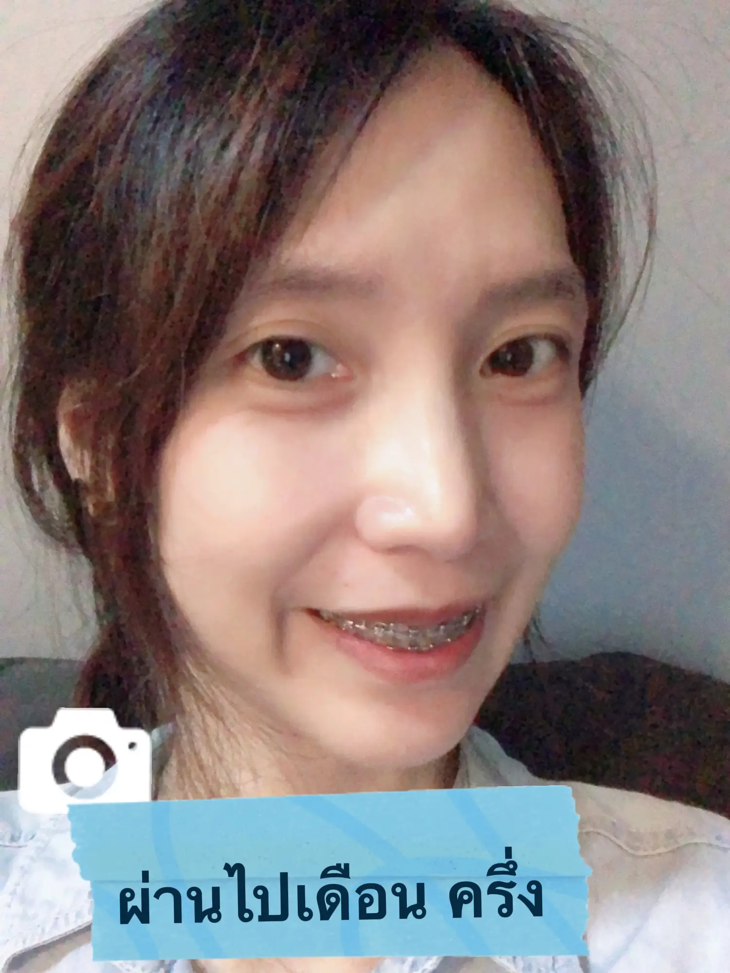 รีวิว😃 อายุใกล้ 40 จัดฟัน ยังทันไหม?? แล้วคอมเม้นท์ด้วยน๊าาา | แกลเลอรี ...