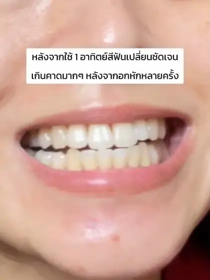 เปิดกรุ 1 อาทิตย์ฟันขาวขึ้นใช้อะไรบ้าง | แกลเลอรีที่โพสต์โดย Tofang ...