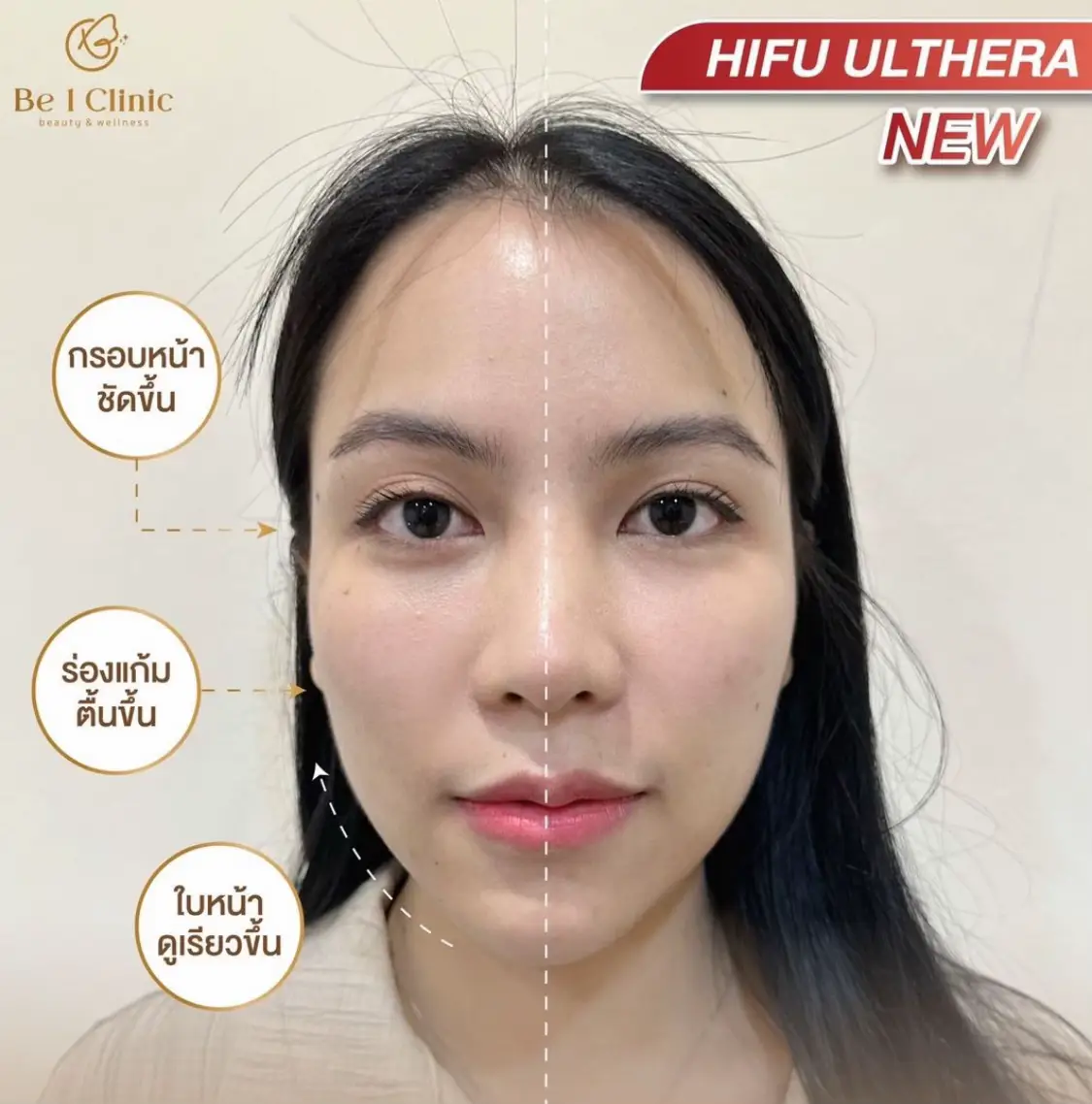 โปรแกรม hifu ยกกระชับแก้มเหนียง | แกลเลอรีที่โพสต์โดย Be1clinic | Lemon8
