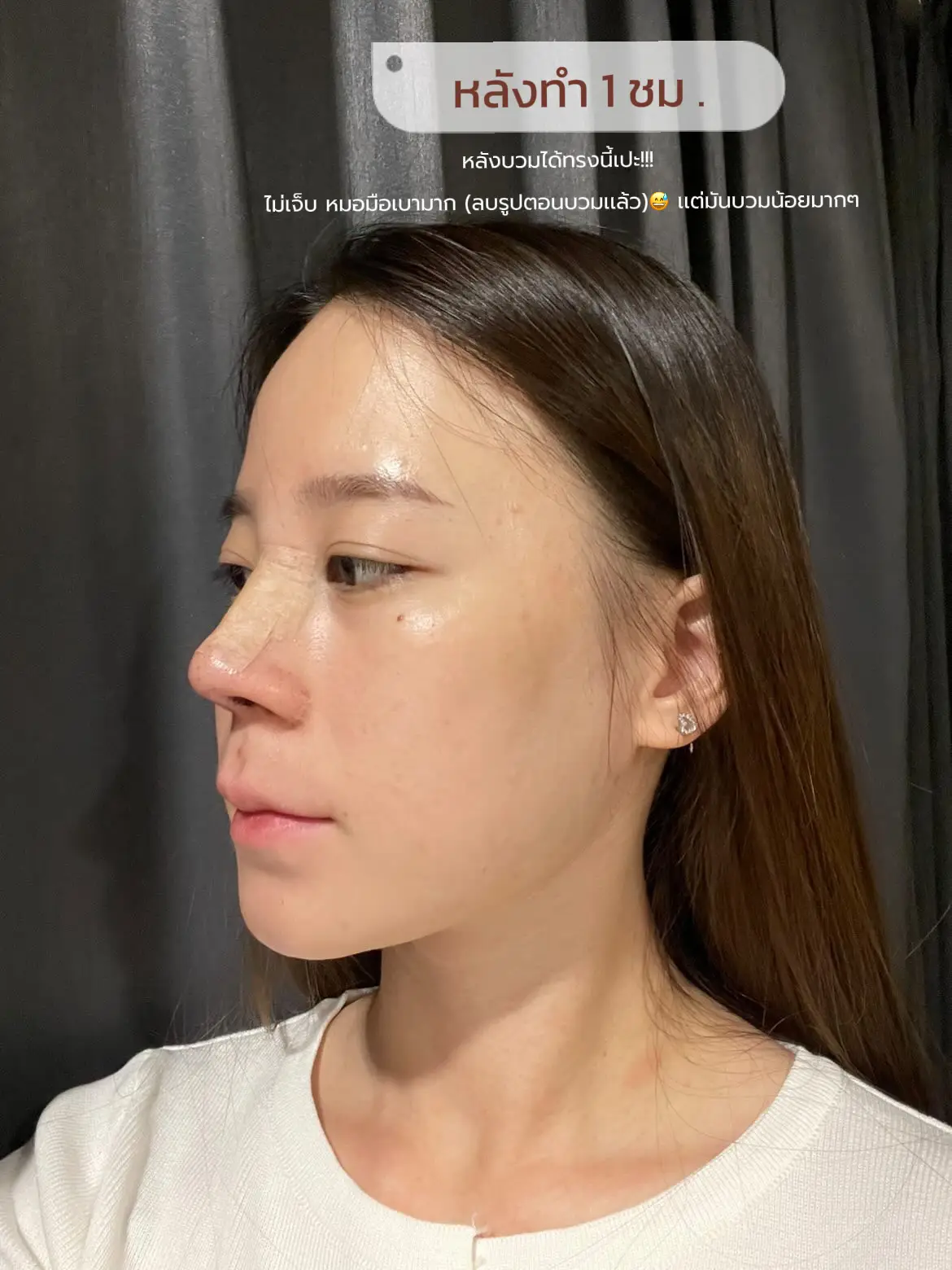 ลดบวม Proctase-P คือ ยา แก้ อะไร - การค้นหาใน Lemon8