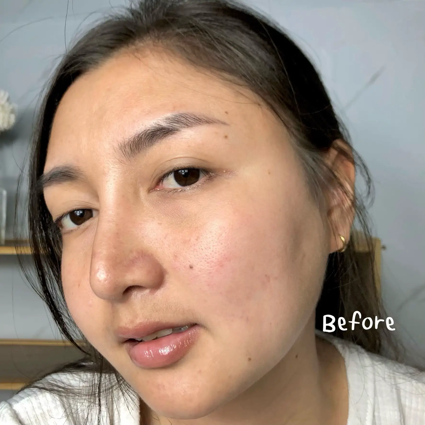 กรดวิตามินเอ?? | แกลเลอรีที่โพสต์โดย Micky Kanjana | Lemon8