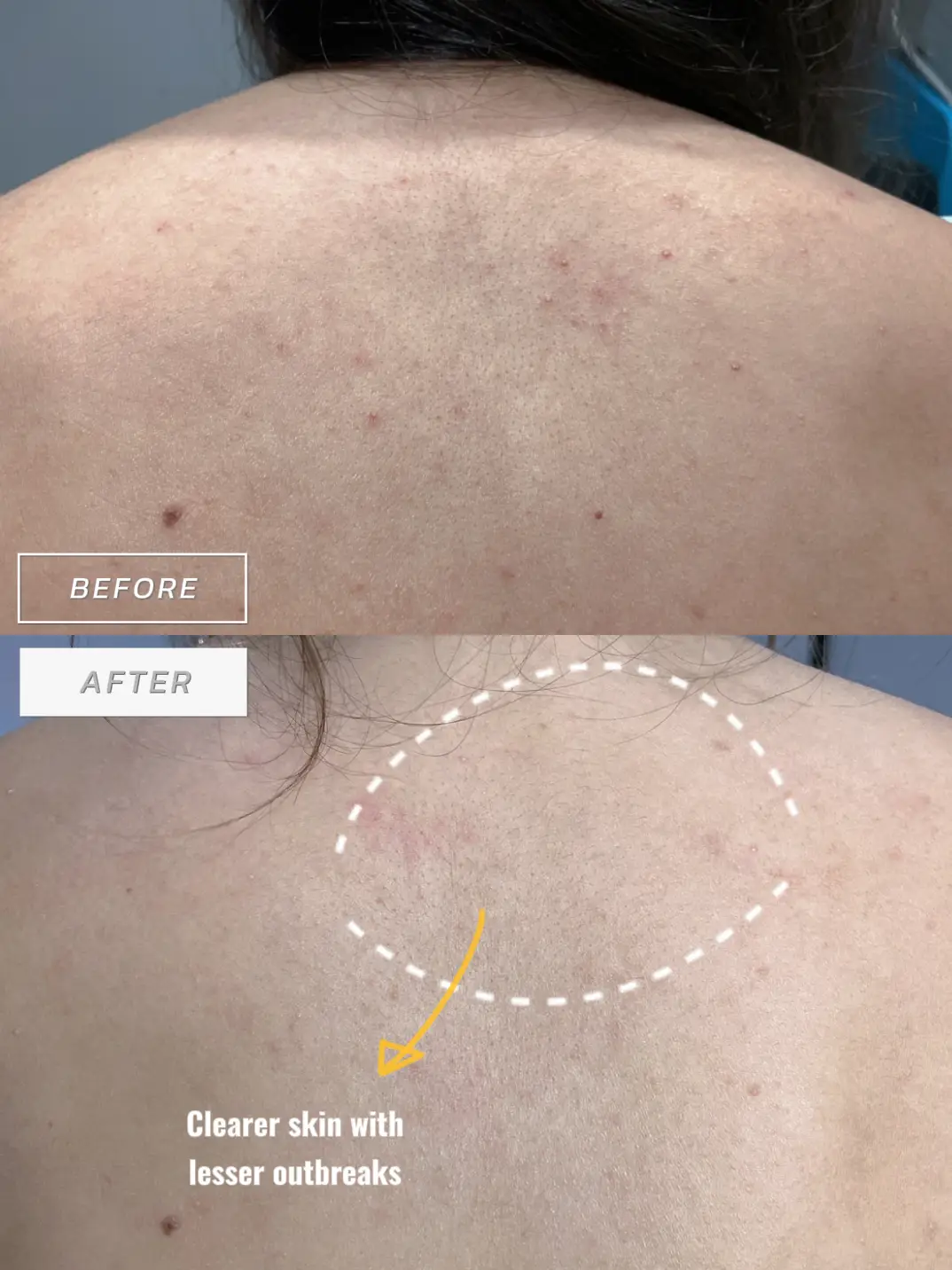 A solution to your skin concerns 😌 | แกลเลอรีที่โพสต์โดย Japan IPL | Lemon8