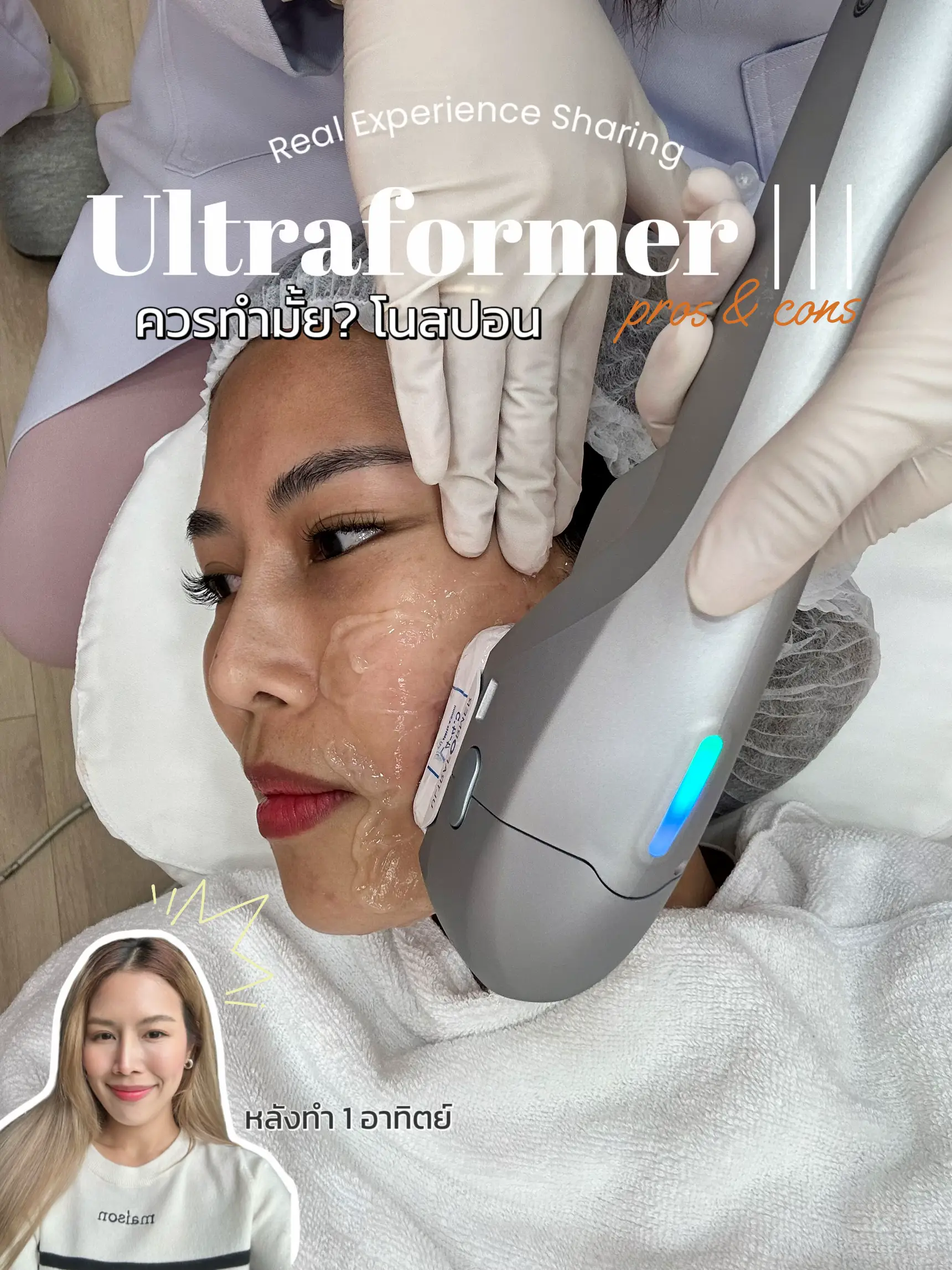 รีวิว Ultraformer III เหมาะกับใคร หน้าเรียวจริงมั้ย? | แกลเลอรีที่โพสต์โดย Tontaey Story | Lemon8