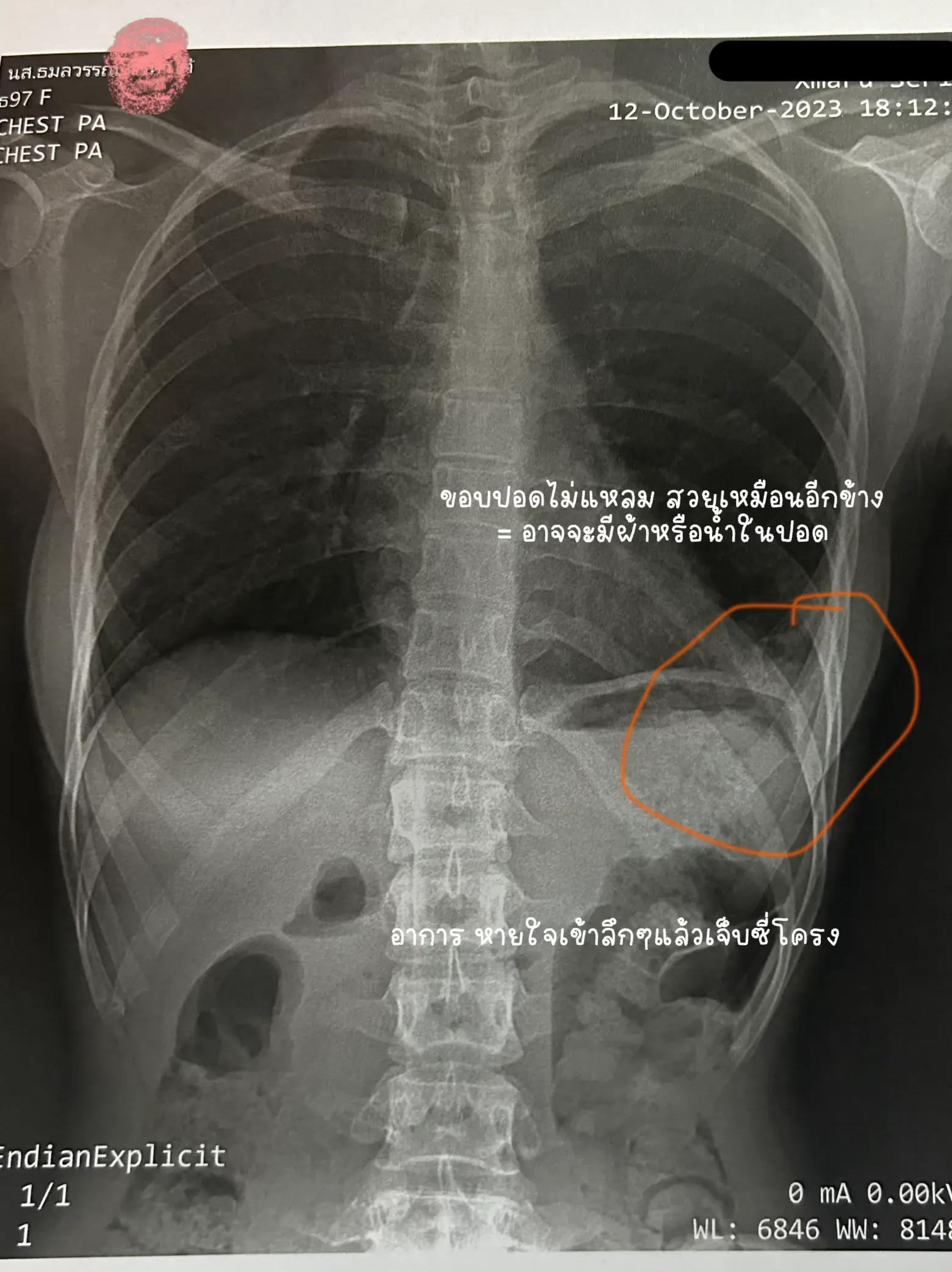19 ไอเดียยอดนิยมเกี่ยวกับ ลดบวม Proctase P คือ ยา แก้ อะไร ในปี 2025
