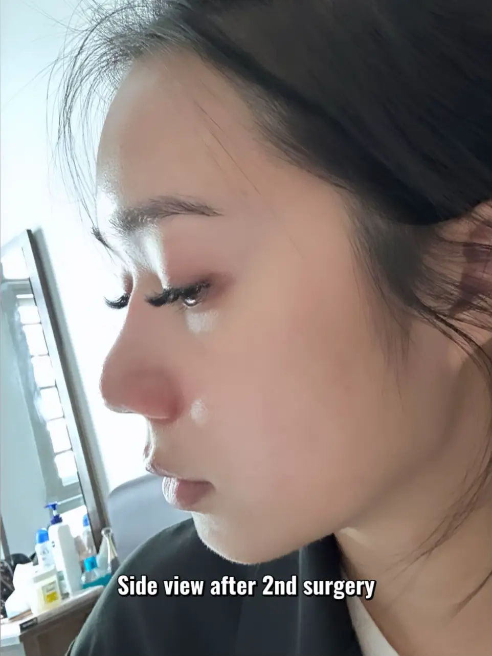 Rhinoplasty surgery 2.0 | Gallery posted by Sallest | Lemon8