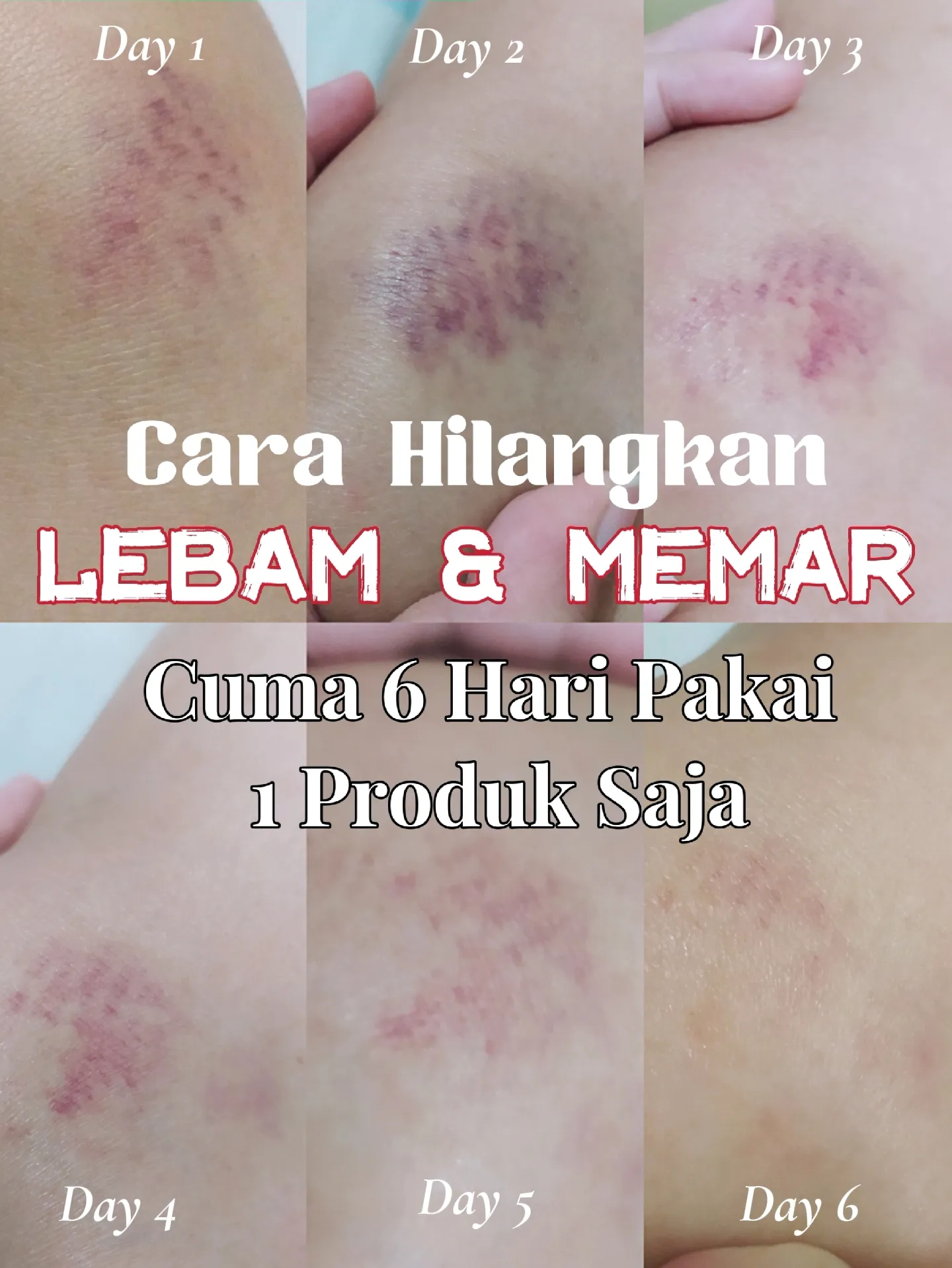 Cara Hilangkan Lebam & Memar Cuma 6 Hari 1 Produk | Galeri diposting ...