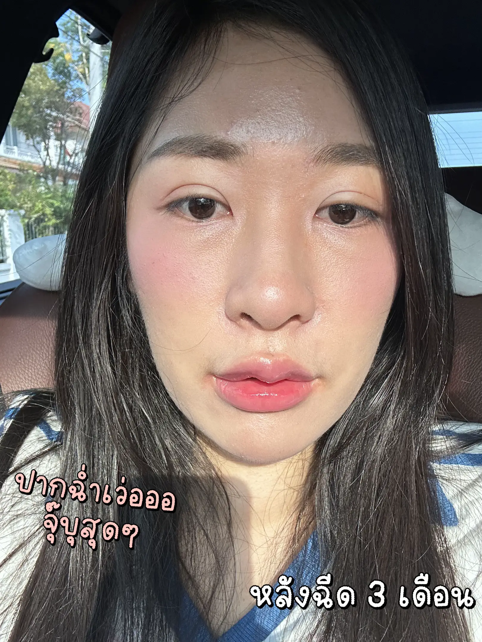 รีวิวประสบการณ์ฉีดหน้าที่เกาหลี💉🇰🇷 | แกลเลอรีที่โพสต์โดย fahsai ⋆𐙚₊˚⊹♡ | Lemon8