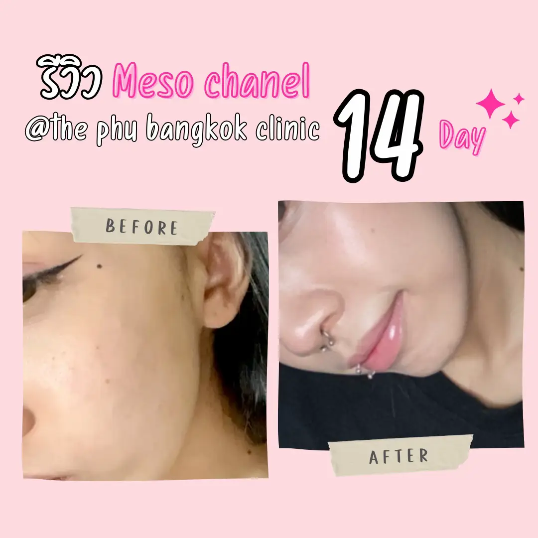 ทำหัตถการครั้งแรกผิวจึ้งมากก{meso chanel}🥹🤘🏻 | แกลเลอรีที่โพสต์โดย Tang | Lemon8