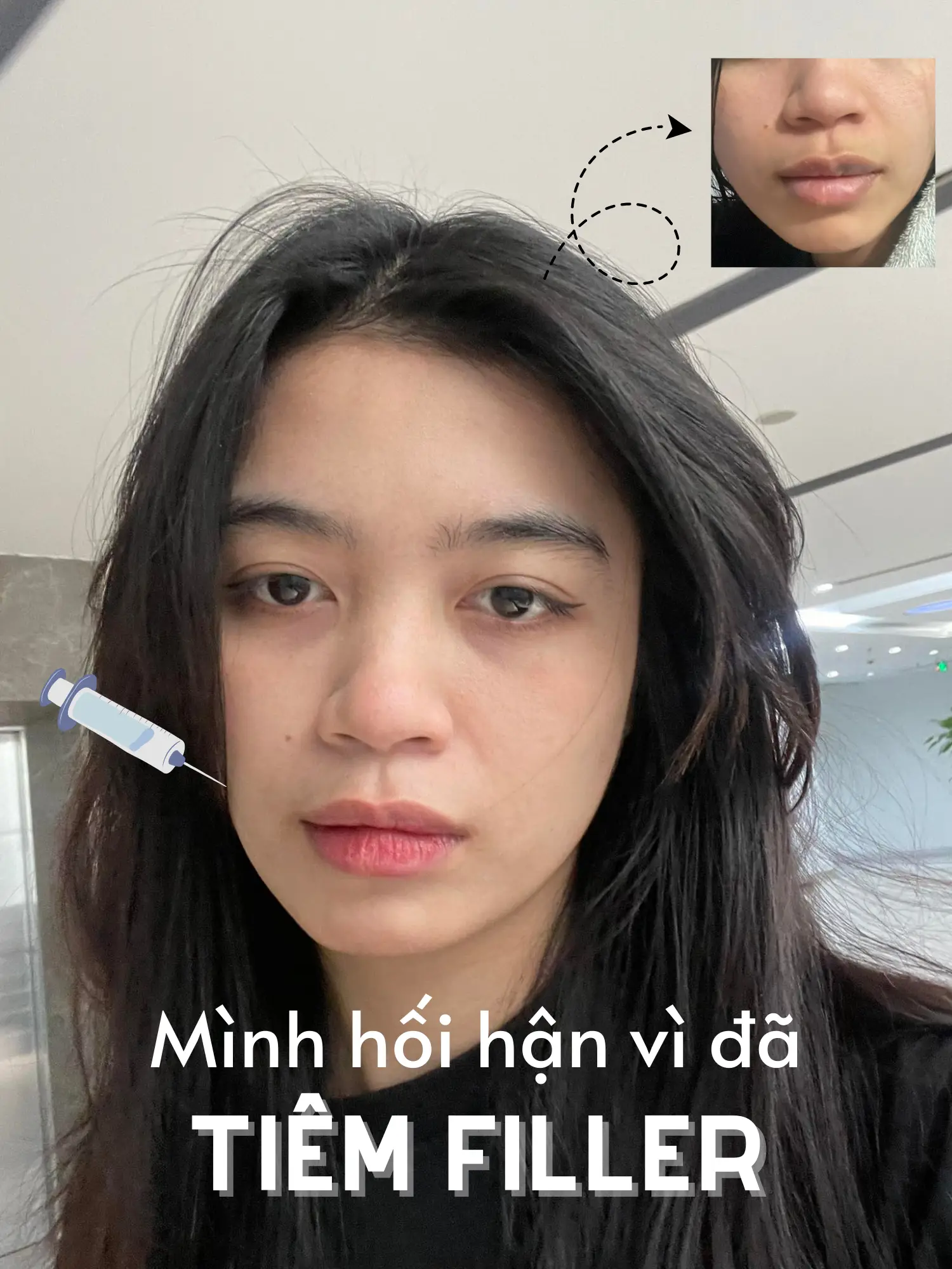 MÌNH HỐI HẬN VÌ ĐÃ… TIÊM FILLER!!!! | Bộ sưu tập do Thục Trang đăng | Lemon8