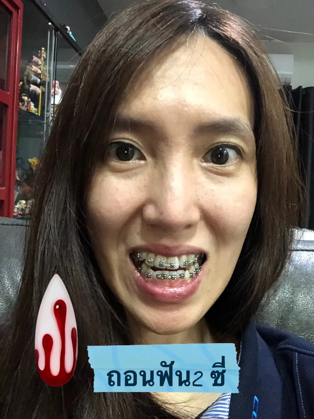 รีวิว😃 อายุใกล้ 40 จัดฟัน ยังทันไหม?? แล้วคอมเม้นท์ด้วยน๊าาา | แกลเลอรี ...