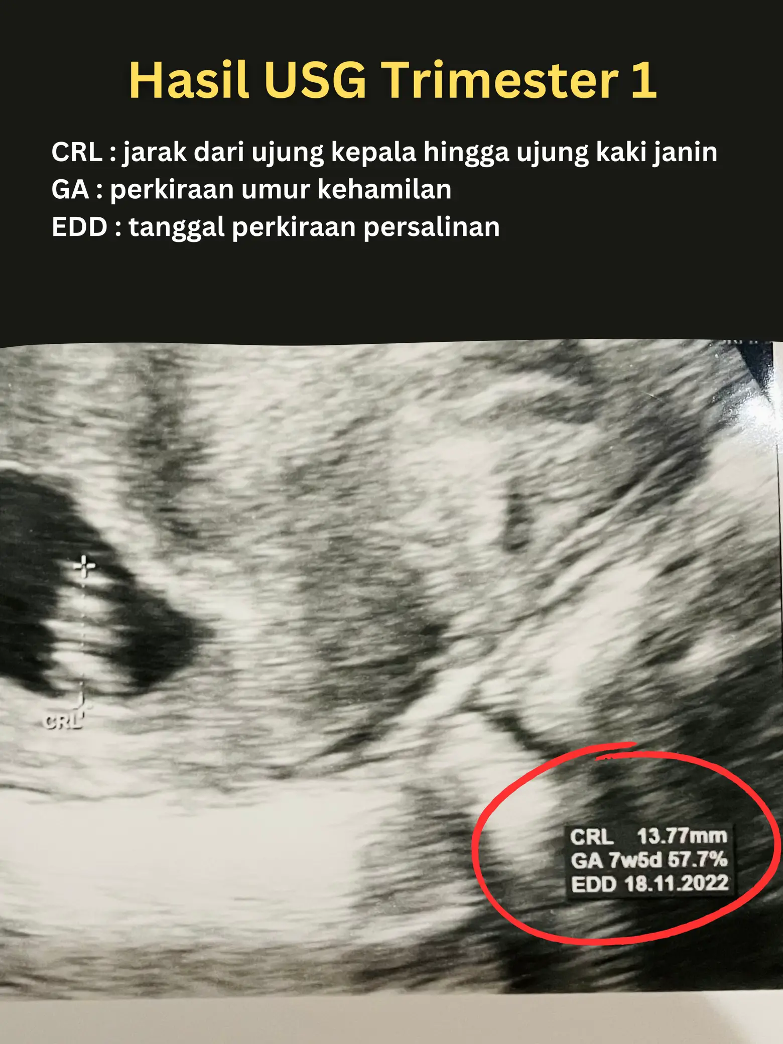 Jangan Salah, Begini Cara Baca Hasil USG Kehamilan | Galeri diposting ...