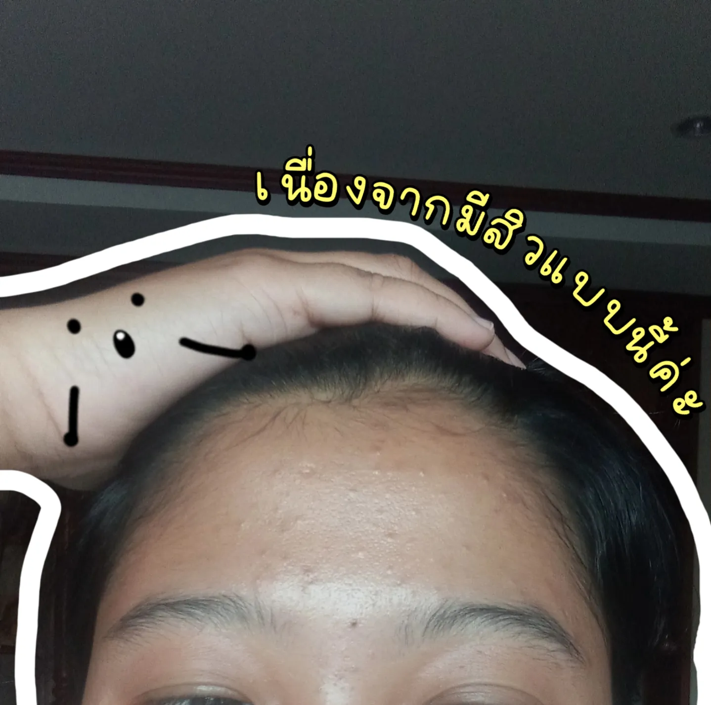 อายุ 16 ใช้Acnetin-a ได้มั้ย | แกลเลอรีที่โพสต์โดย omiom | Lemon8