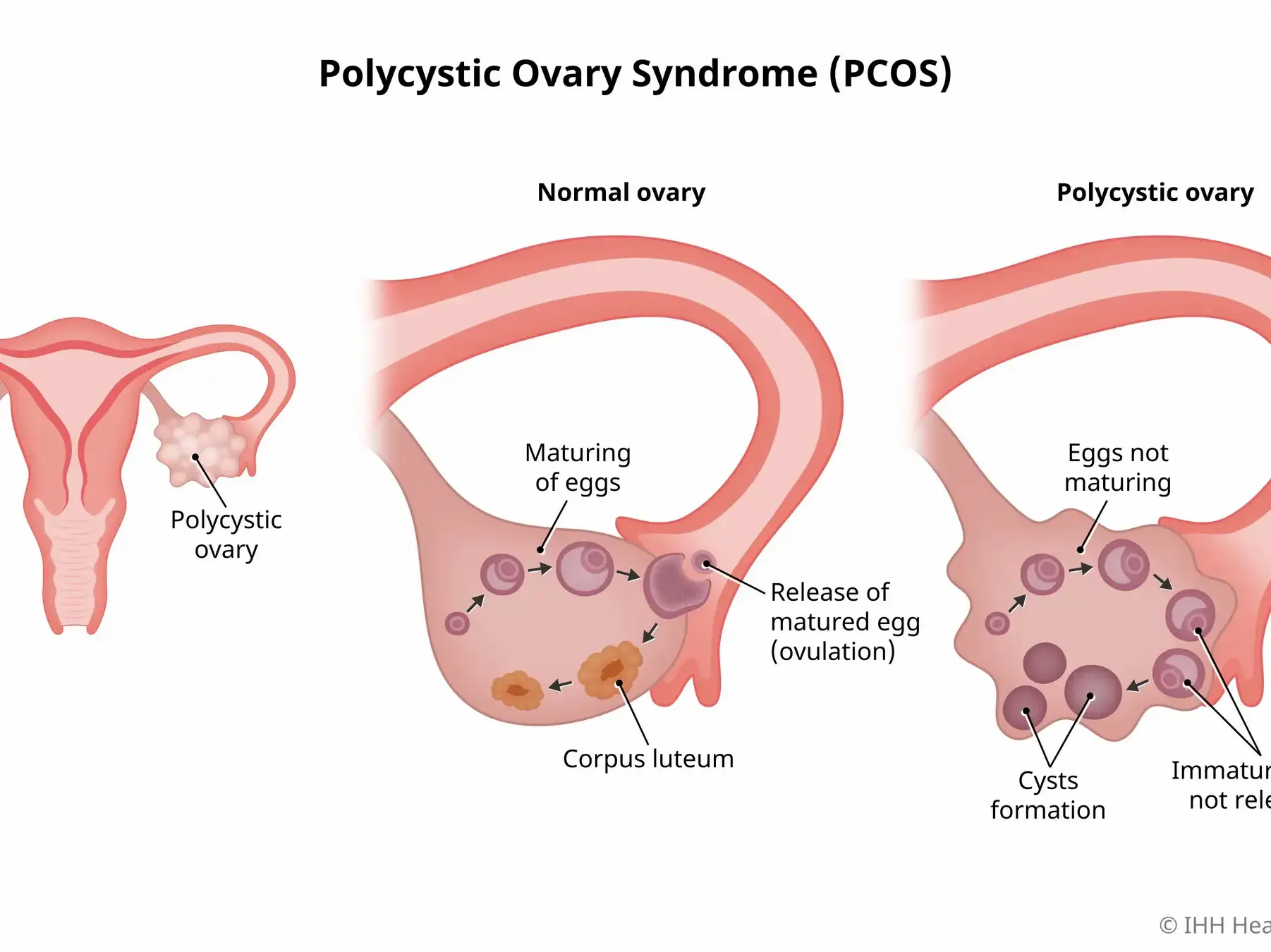 ตรวจเจอ PCOS โรคที่พบบ่อยในวัยรุ่นหญิง | แกลเลอรีที่โพสต์โดย :D | Lemon8