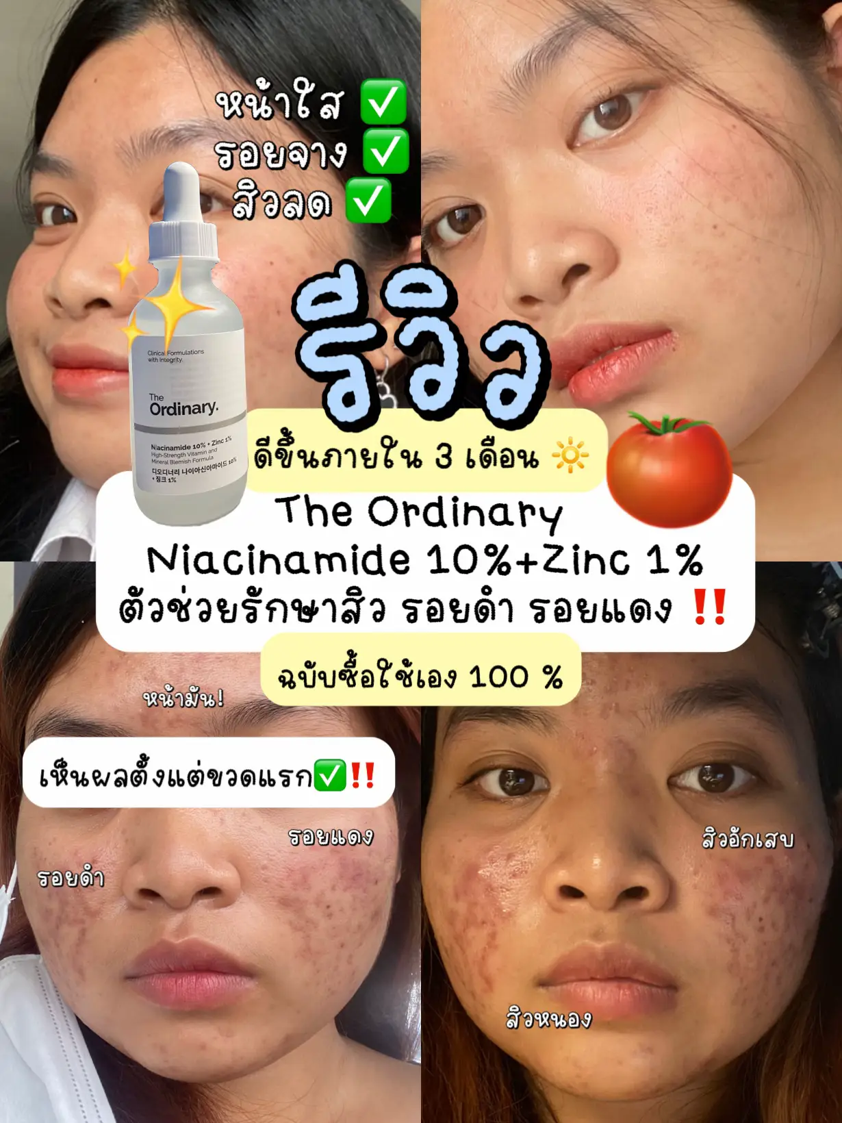 รีวิวThe Ordinary Niacinamide ดีจริงหรือจกตา ‼️ | แกลเลอรีที่โพสต์โดย ...