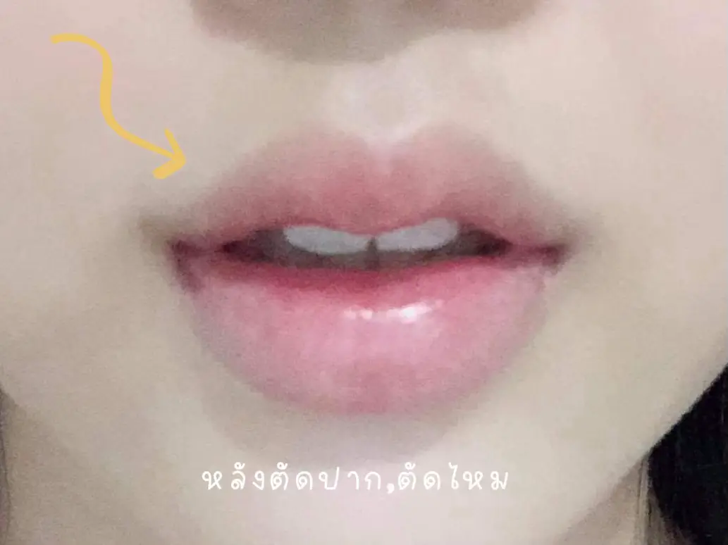 รีวิวตัดปาก กับหมออันดับ1 ของไทย👄 | แกลเลอรีที่โพสต์โดย Orm aam | Lemon8