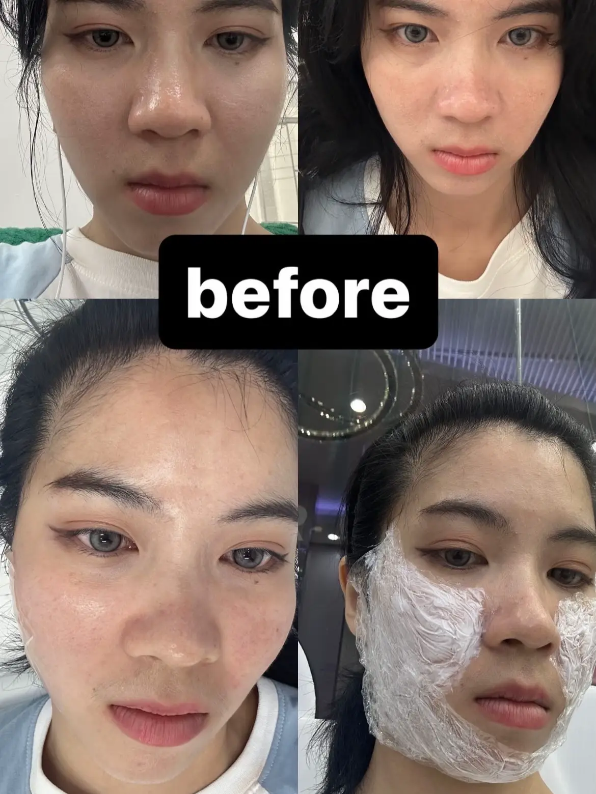 สายเซลฟี่ไปทำhifuด่วนนน! | แกลเลอรีที่โพสต์โดย Mossarellaaa | Lemon8