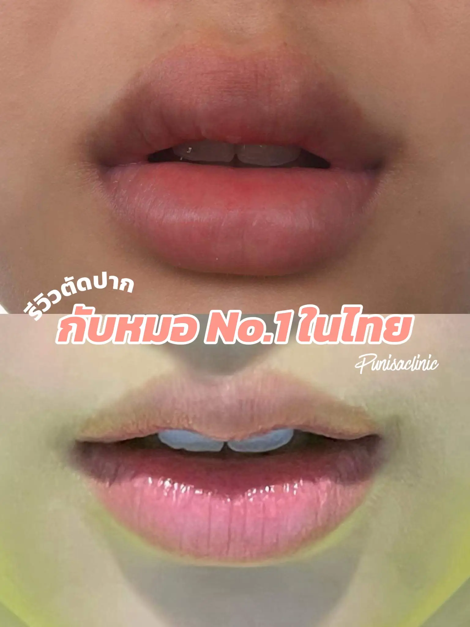 รีวิวตัดปาก กับหมออันดับ1 ของไทย👄 | แกลเลอรีที่โพสต์โดย Orm aam | Lemon8