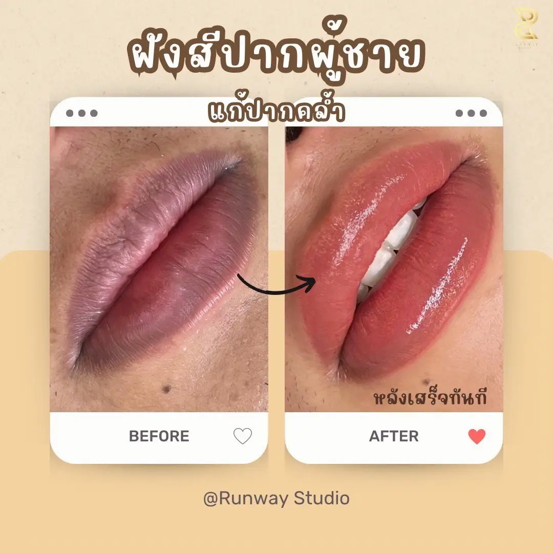 รีวิว ฝังสีปากผู้ชาย ฝังสีปากแก้ปากคล้ำผู้ชาย | แกลเลอรีที่โพสต์โดย RUNWAY STUDIO | Lemon8