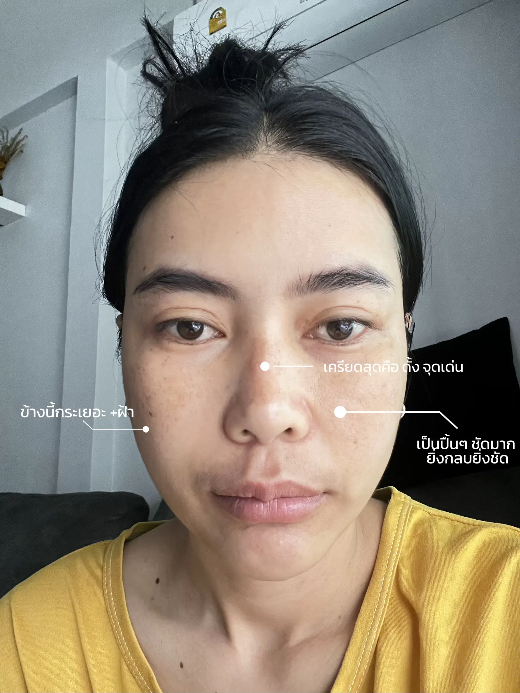 ทดลองใช้ครบ1เดือน สู้กับฝ้า🥺 | แกลเลอรีที่โพสต์โดย 𝗠𝗨𝗞 | Lemon8