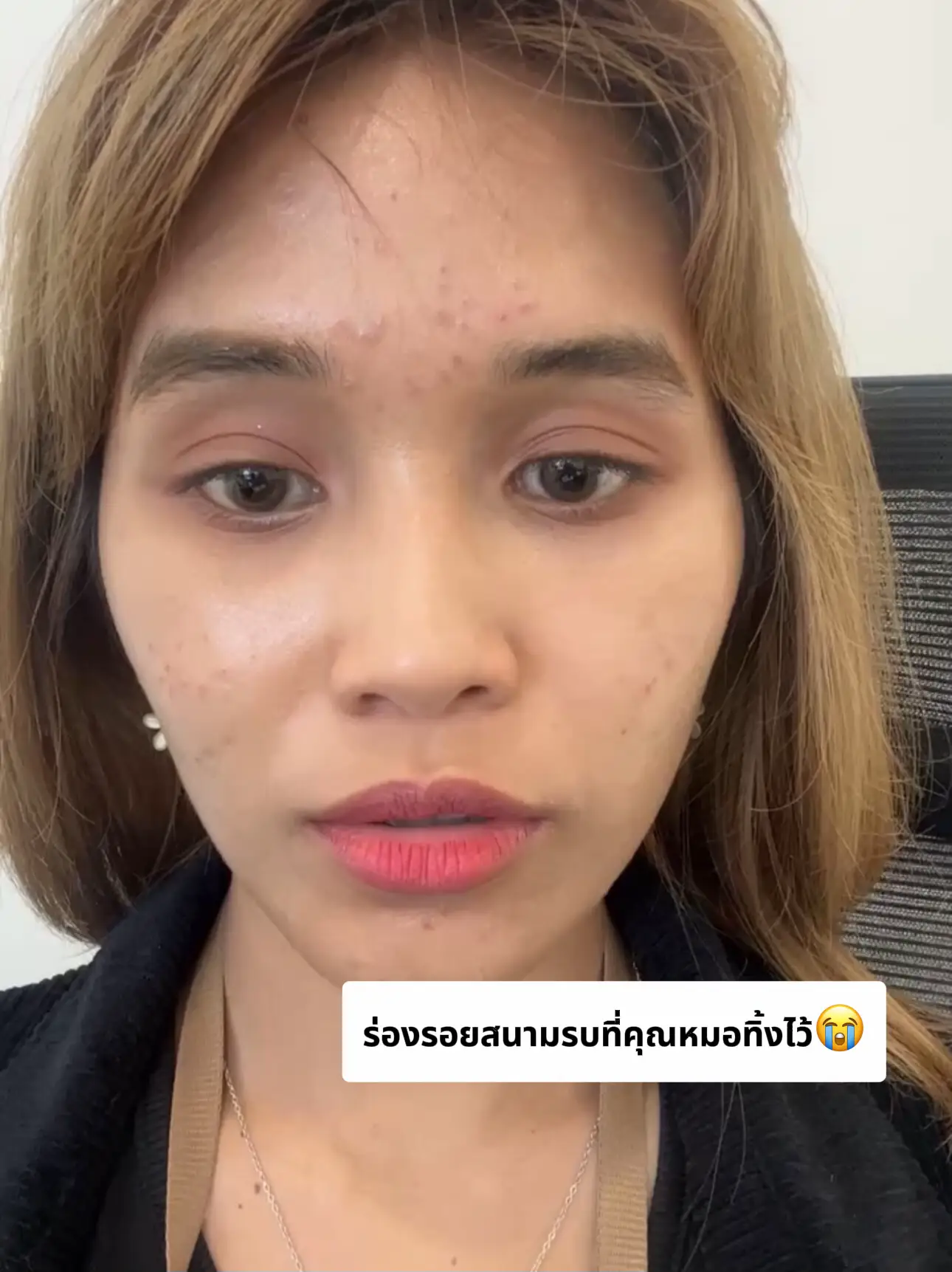แชร์ประสบการณ์สิวเชื้อรา เลวร้ายที่สุดในชีวิต จิตตกมาก ⁉️ แกลเลอรีที่