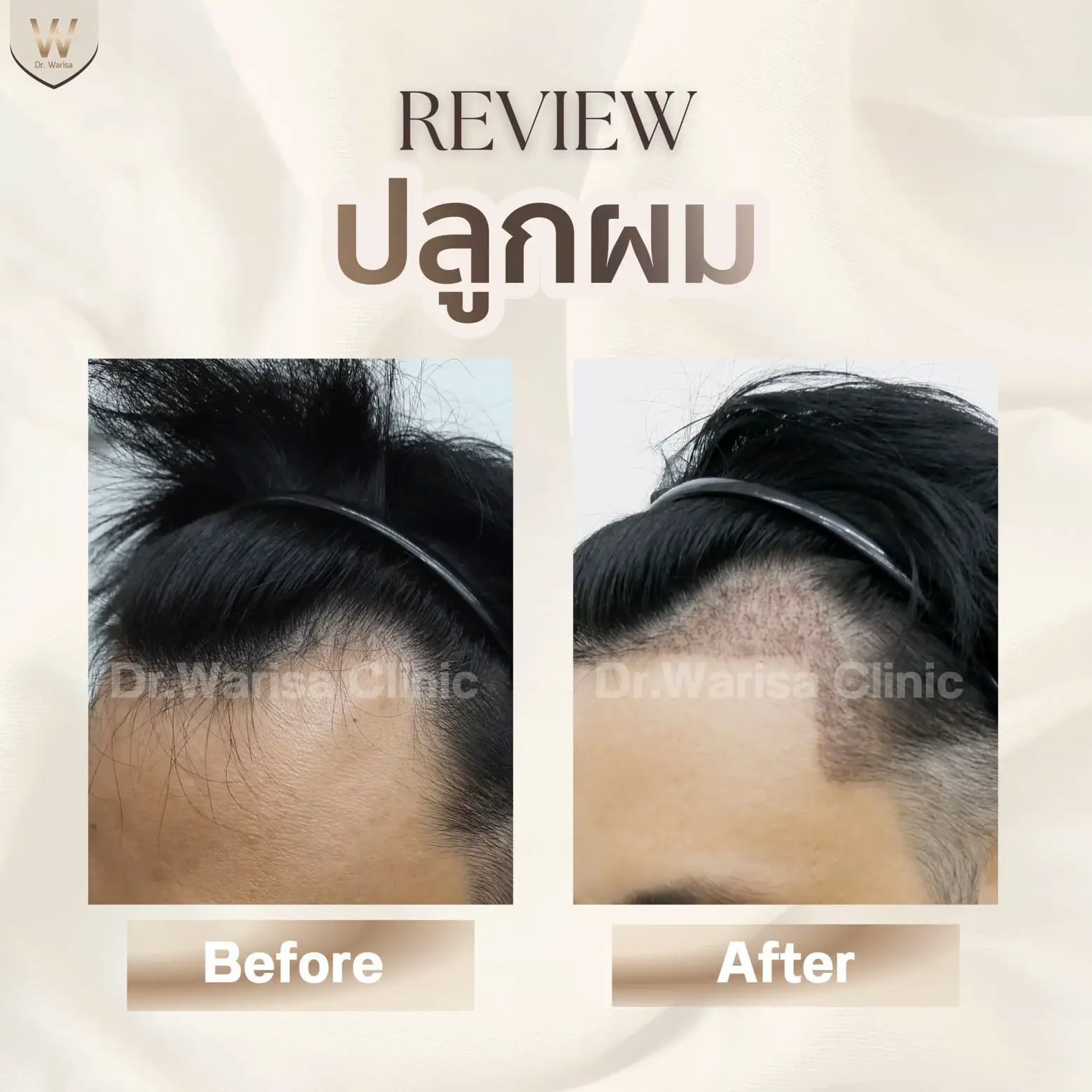 รีวิวหลังจากปลูกผม | แกลเลอรีที่โพสต์โดย Dr.Warisa | Lemon8
