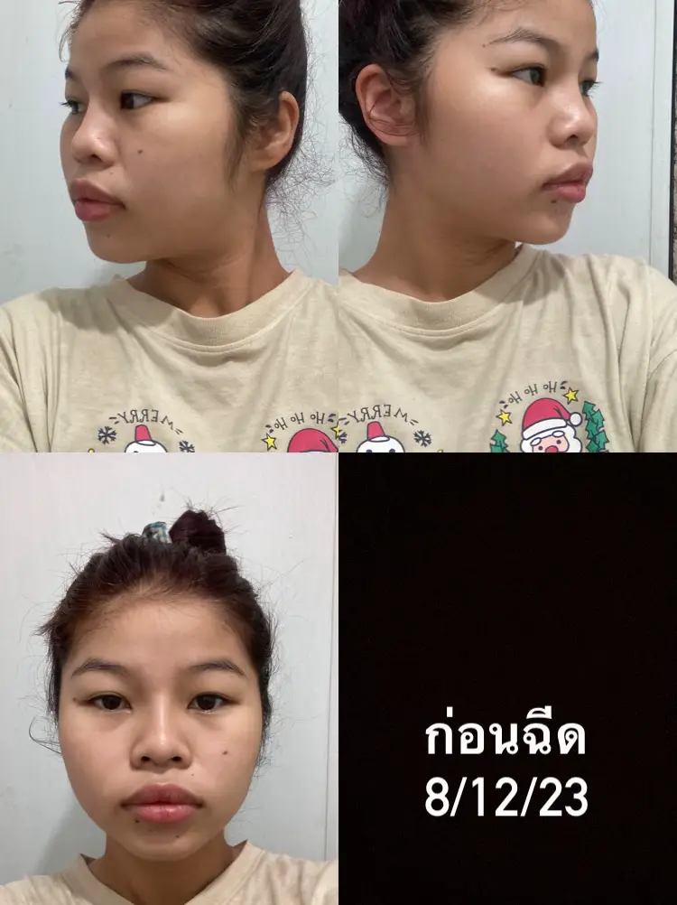 ฉีดโบกราม+ลิฟต์กรอบหน้าครั้งแรก | แกลเลอรีที่โพสต์โดย 𝐄𝐫𝐧𝐠 𝐀𝐨𝐞𝐲 | Lemon8