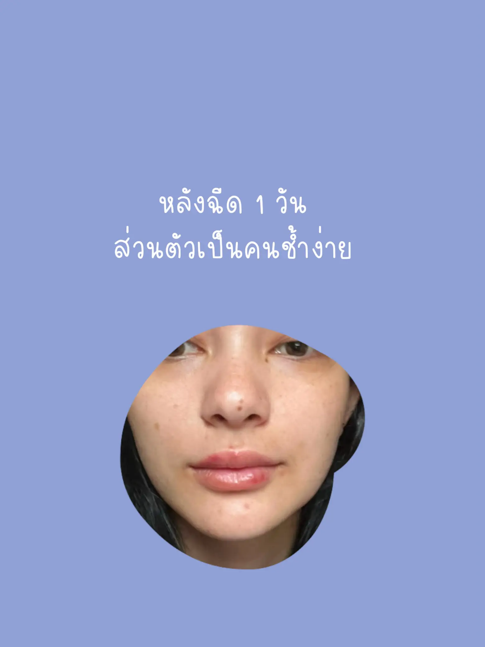 รีวิวทำหัตถการครั้งแรก (ฉีดปาก) ที่ธรรมดาคลินิก | แกลเลอรีที่โพสต์โดย Sofia H. | Lemon8