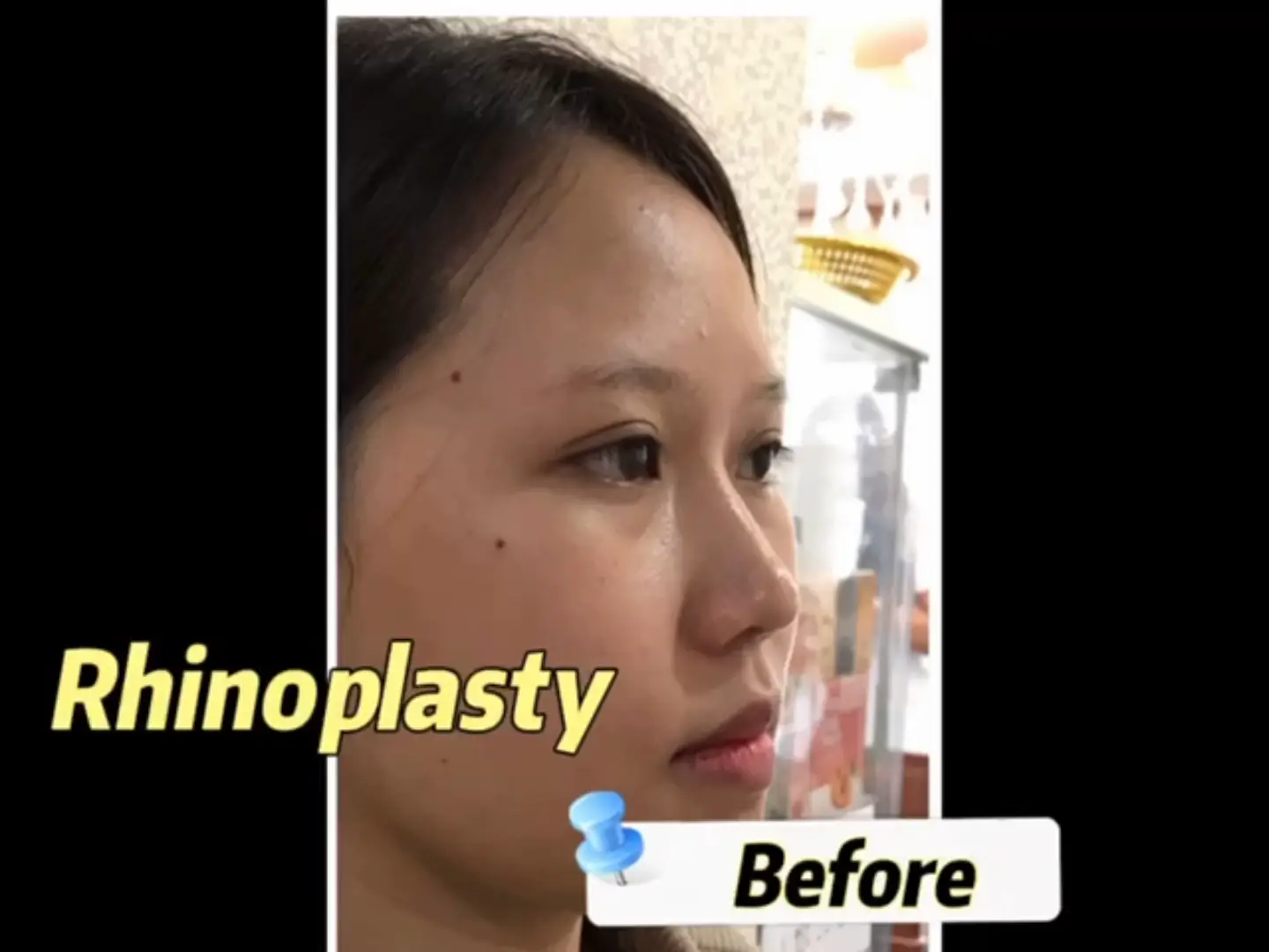 #เสริมจมูกขอนแก่น #แก้จมูกขอนแก่น #สมบูรณ์แบบในแบบที่เป็นคุณ | วิดีโอที่เผยแพร่โดย SBclinic_kk ...