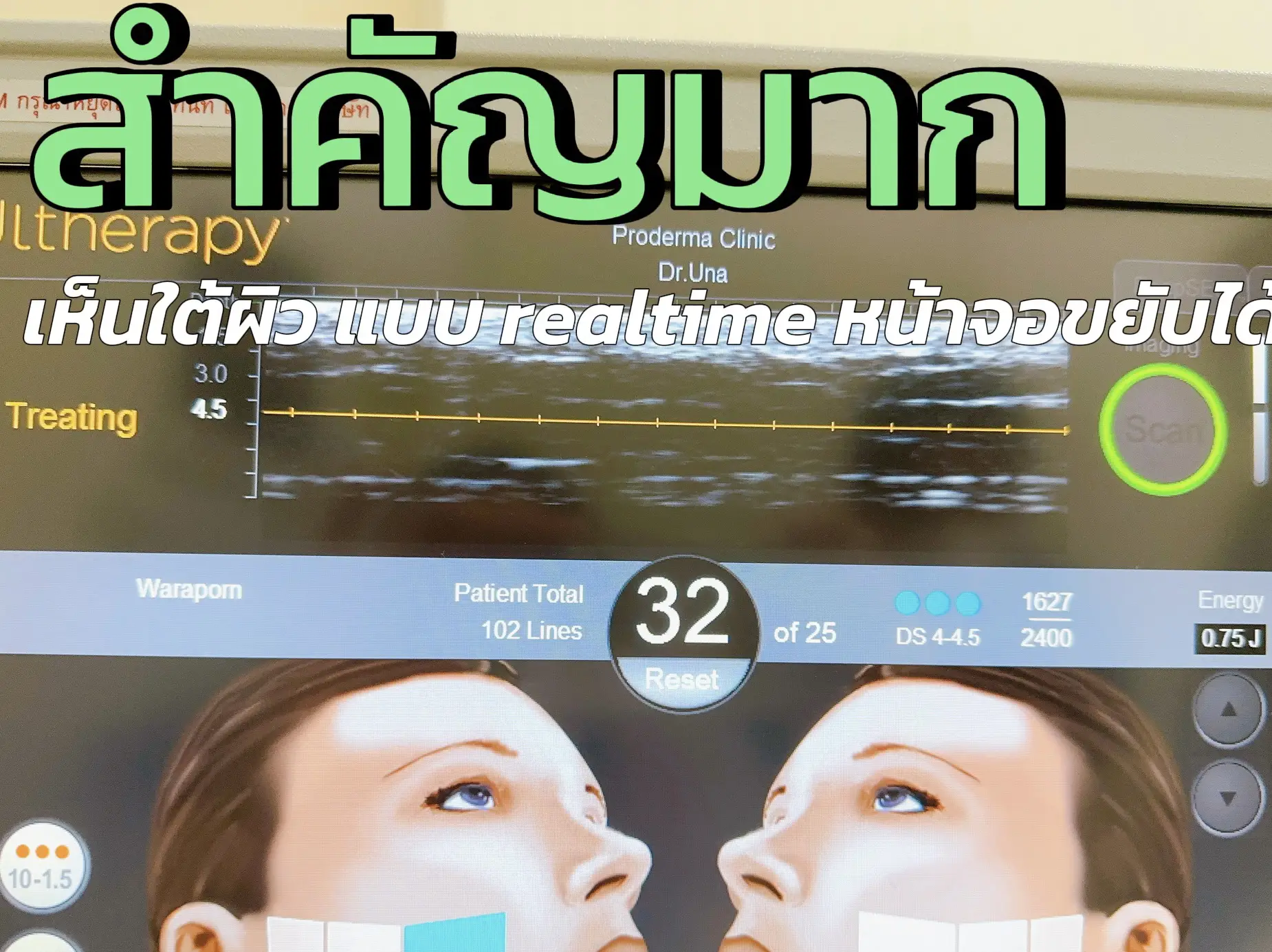 หน้าจอ Ulthera บอกอะไรเราบ้าง | แกลเลอรีที่โพสต์โดย ProDerMa | Lemon8