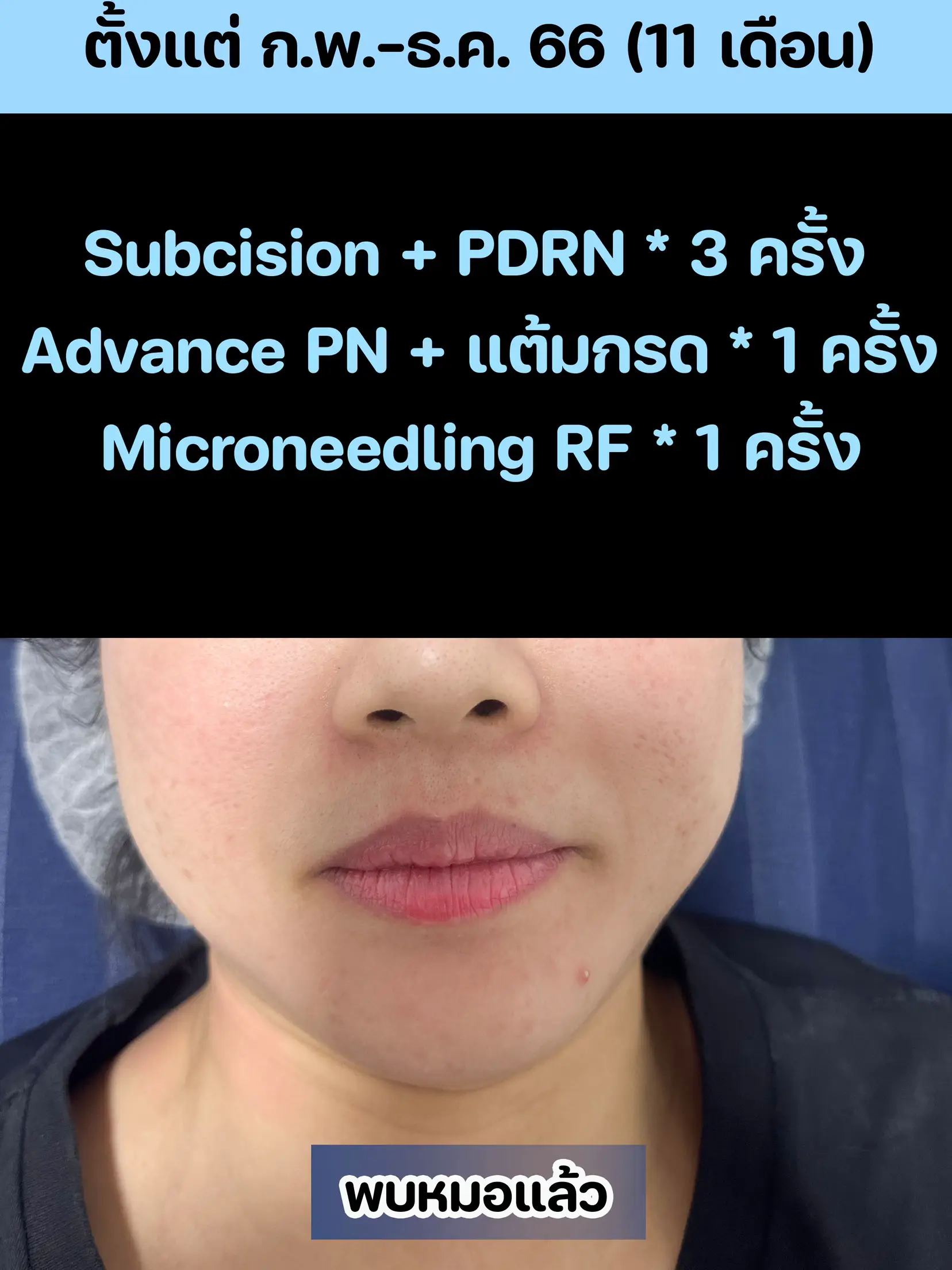 3*1*1 จำนวนครั้ง ของการรักษา มีอะไรบ้าง มาดู | แกลเลอรีที่โพสต์โดย Dr.Ploy รุ่งนภา | Lemon8