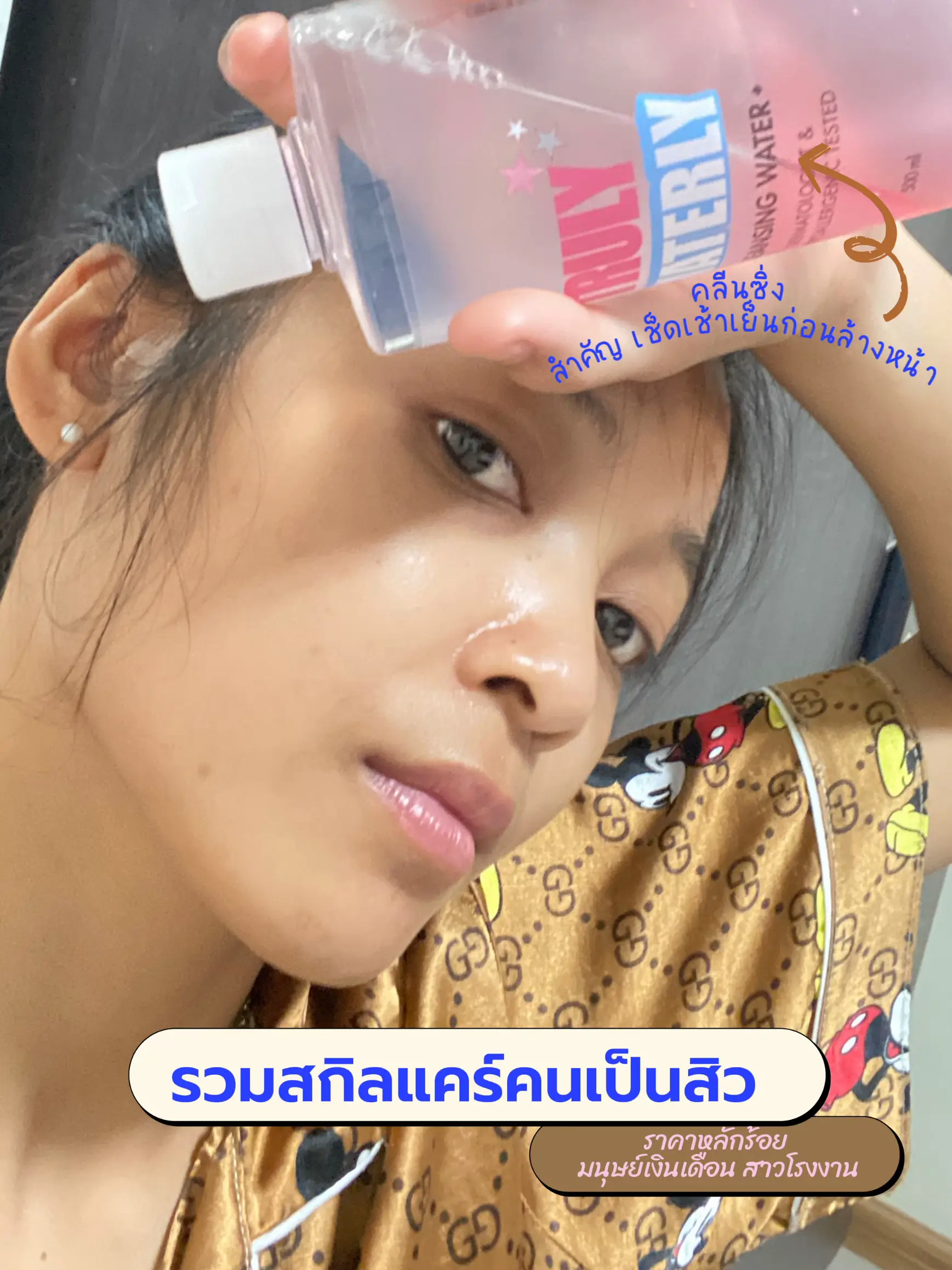 สกิลแคร์รักษาสิวงบหลักร้อย | แกลเลอรีที่โพสต์โดย Mod_luckkana