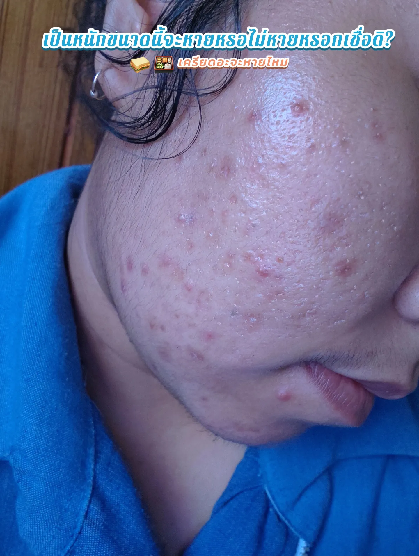 เป็นหนักขนาดนี้จะหายหรอไม่หายหรอกเชื่อดิ? | แกลเลอรีที่โพสต์โดย Diw | Lemon8