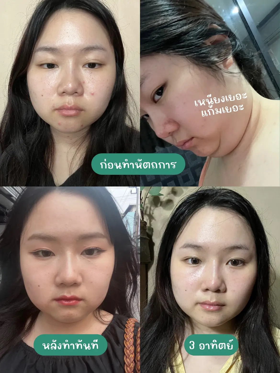 รีวิวฉีดแฟตฉบับราคาดีมากกก + ทริคเลือกคลินิก! | แกลเลอรีที่โพสต์โดย 🍈 ...