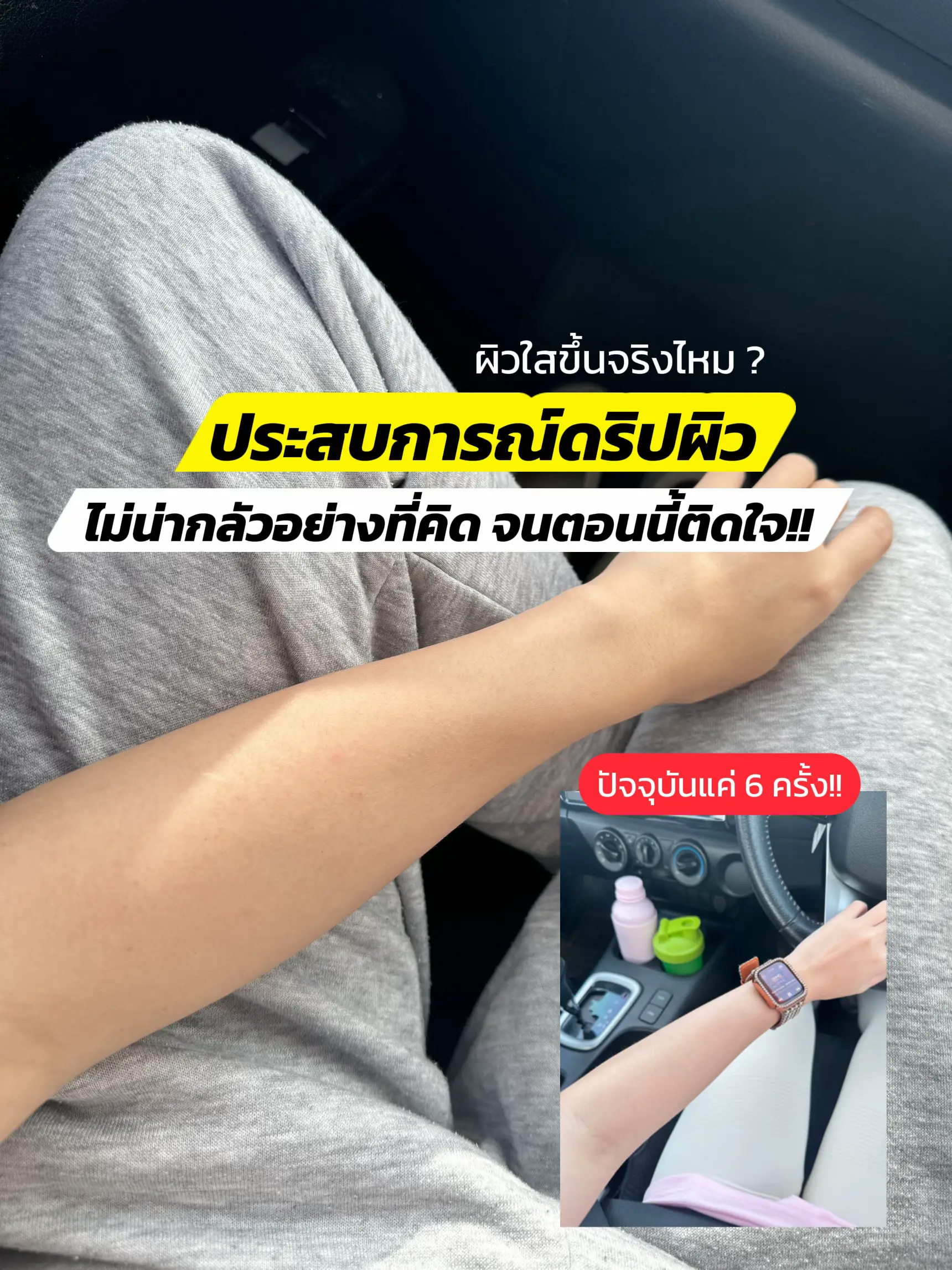 ดริปผิว 6 ครั้ง💉 ผิวดีขึ้นจริงไหม ? 👀 | แกลเลอรีที่โพสต์โดย ssompns | Lemon8