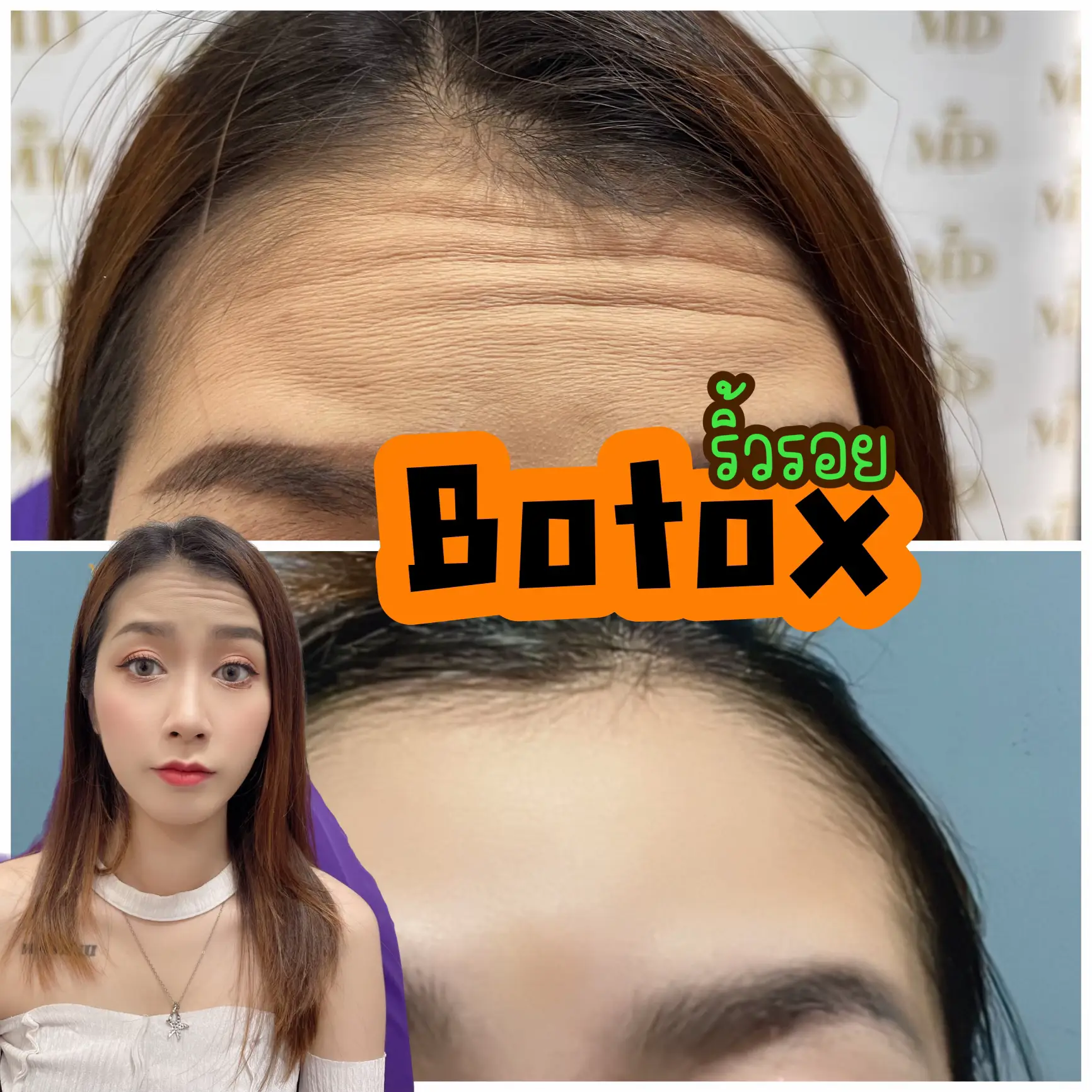 Botox Wrinkle Review | Gallery posted by Md clinic | Lemon8