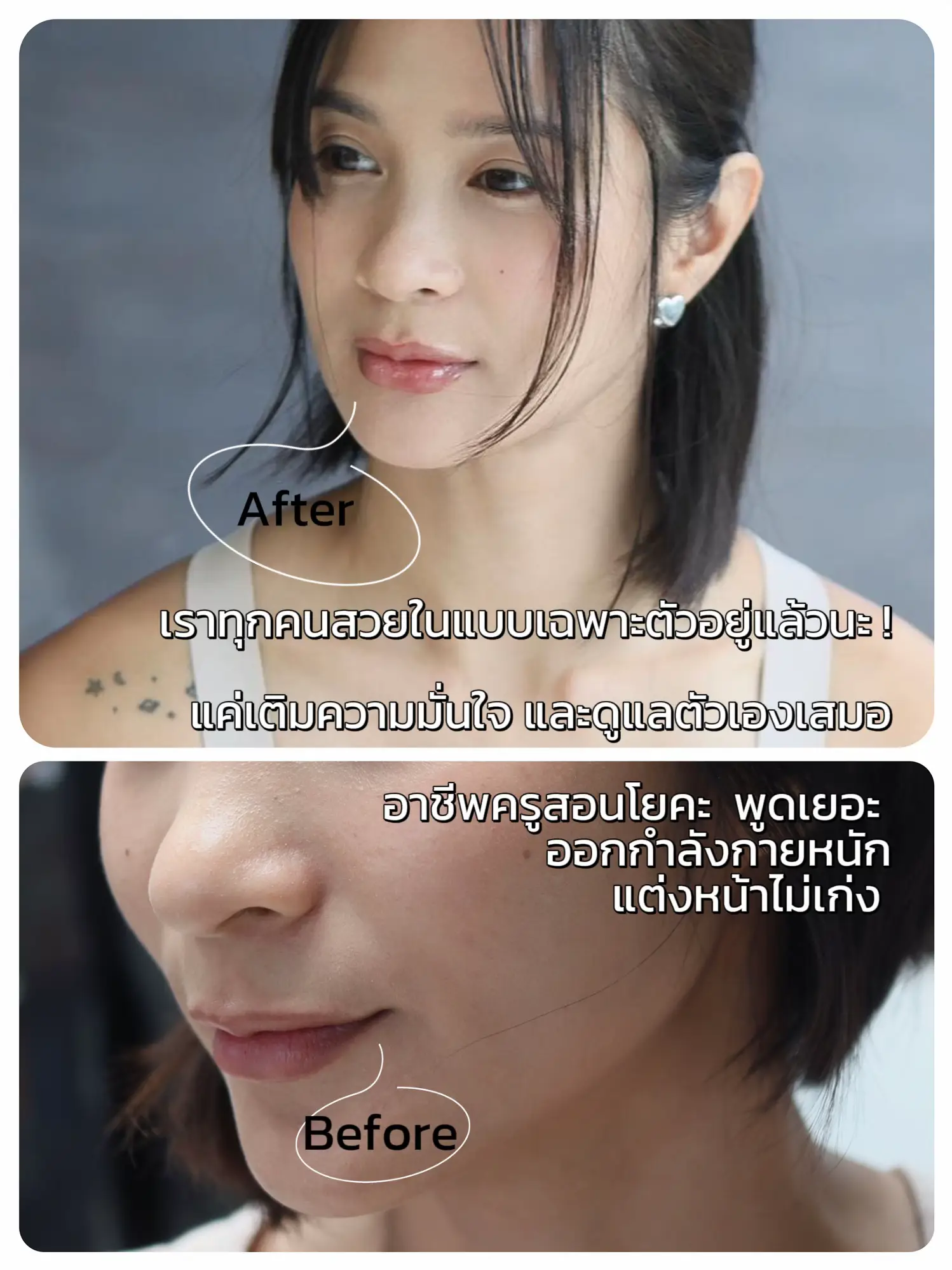 เตรียมตัวก่อนไปทำสวยยังไง ? ฉีดฟิลเลอร์ปากแบบไม่บ้ง | แกลเลอรีที่โพสต์โดย Nae Napassorn | Lemon8